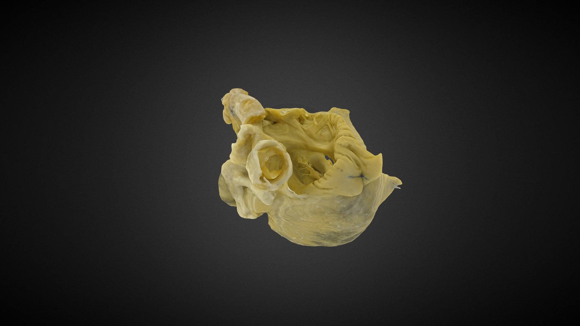 49: HLHS with intact atrial septum - 3D model by CHOP Cardiac Specimens ...