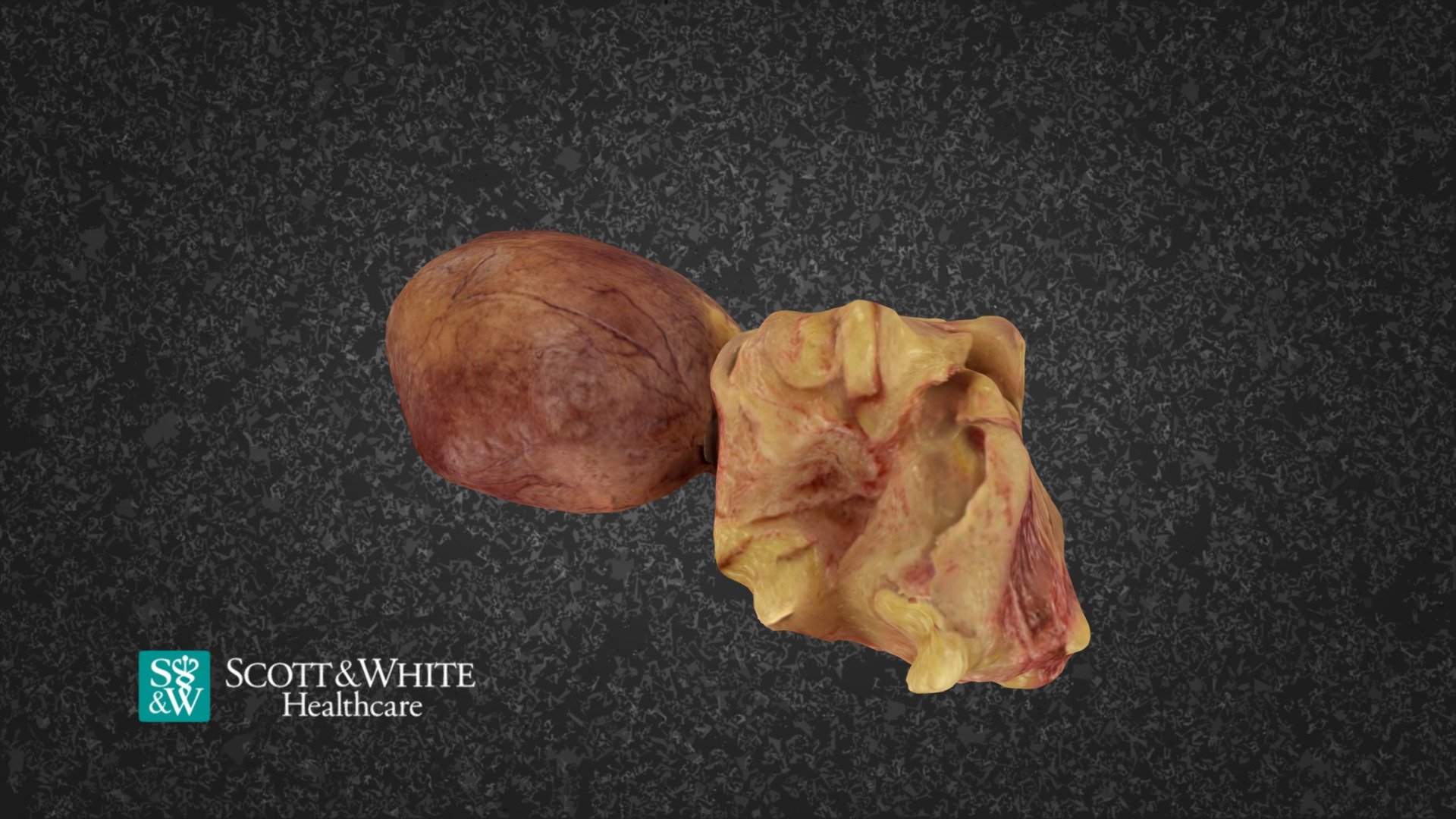Uterus Fibromyomata 134230 - 3D model by Scott & White Moulage Project ...