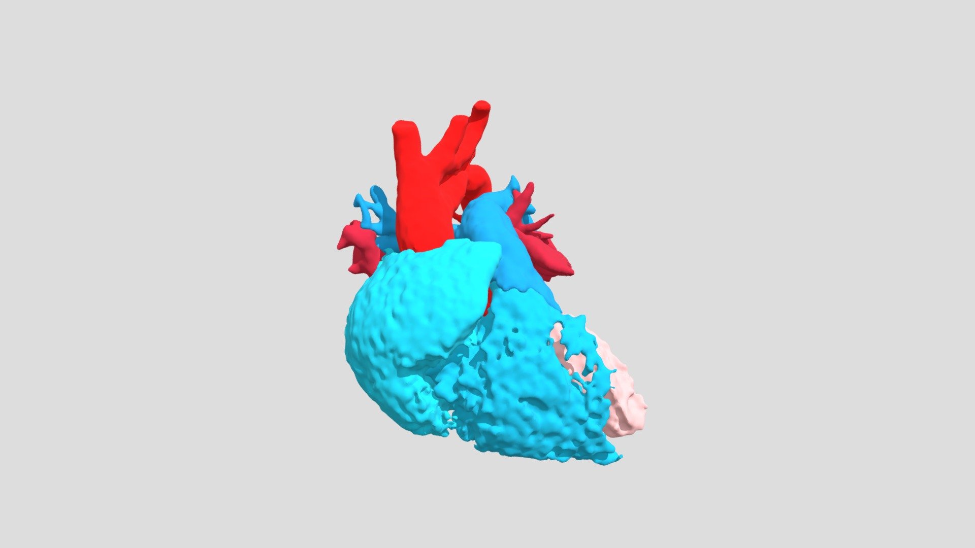 Double Aortic Arch; Coarctation of Aorta (S0354) - 3D model by NCHS ...