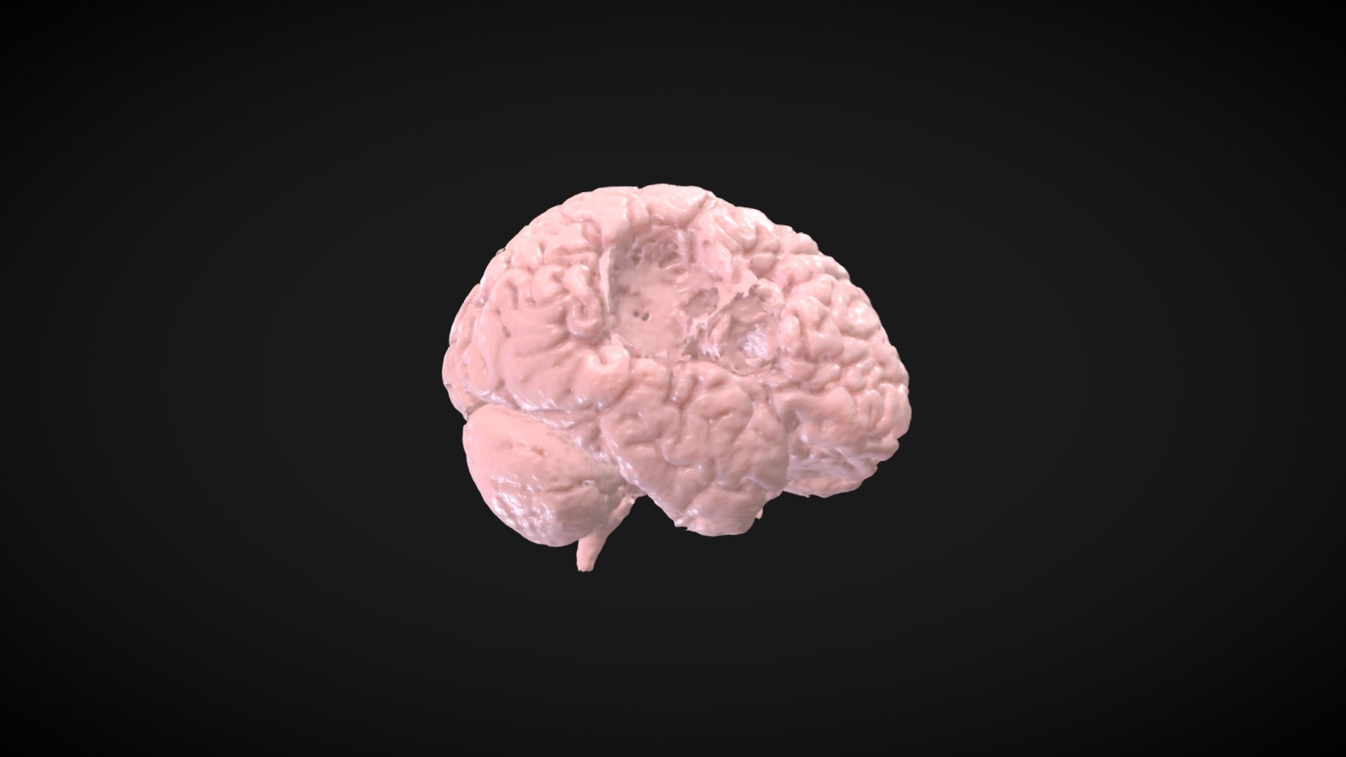 Brain cyst - 3D model by Lincoln Wong (@lincolnwong) [63a43d9] - Sketchfab