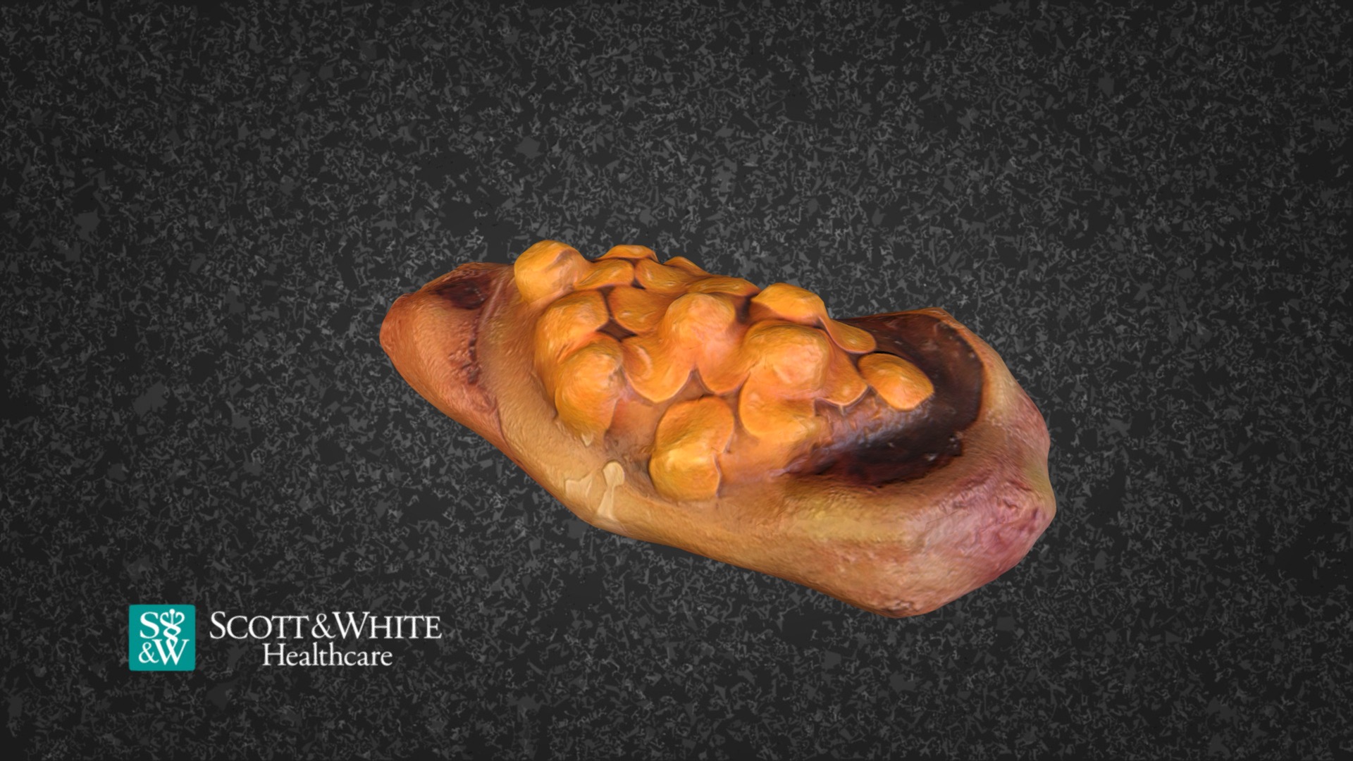 Gallbladder Cholesterol Gallstones 188776 - 3D model by Scott & White ...