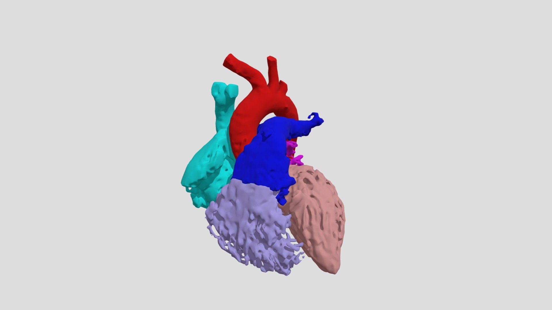 Myocarditis (S0297) - 3D model by NCHS Cardiac Advanced Projects Lab 3D ...