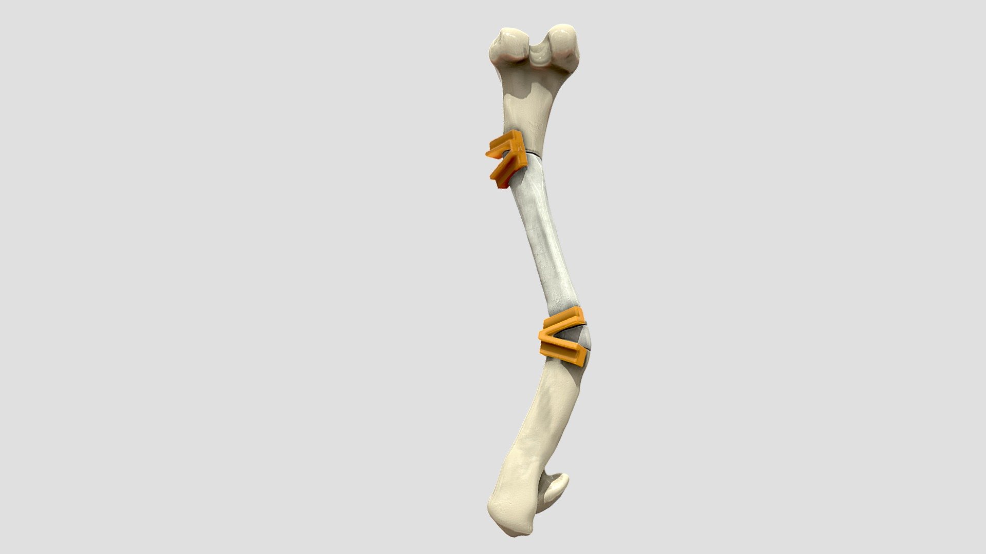 Femur Cutting guides - 3D model by b-onic by Rayo-seco Systems (@b-onic ...