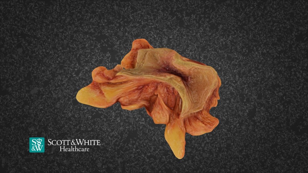 Sigmoid Carcinoma 107999 - 3D model by Scott & White Moulage Project ...