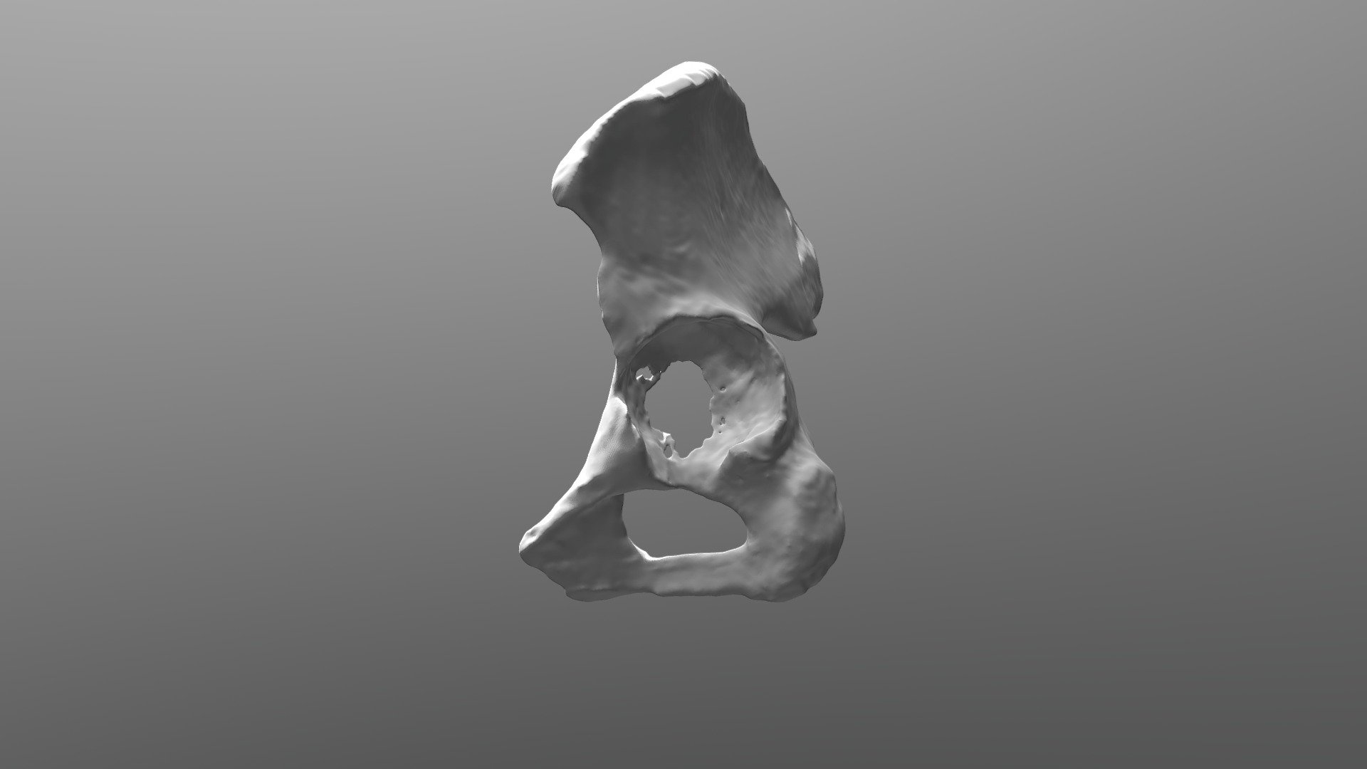 Acetabulum after unsuccessful hip prosthesis - 3D model by valchanov ...