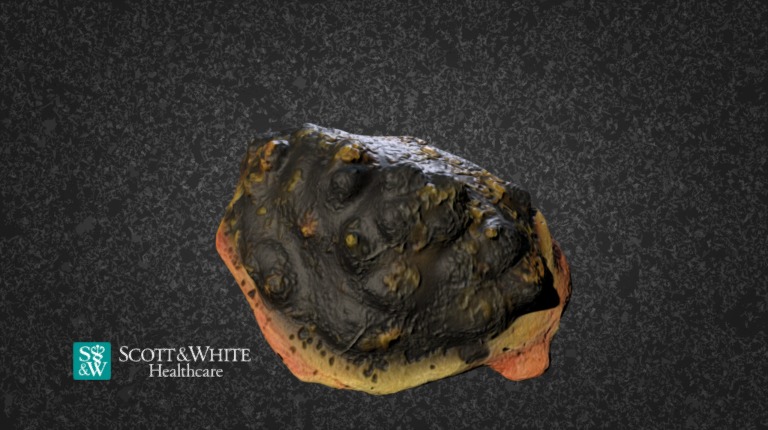 Gallbladder With Carbon Stones 161630 - 3D model by Scott & White ...