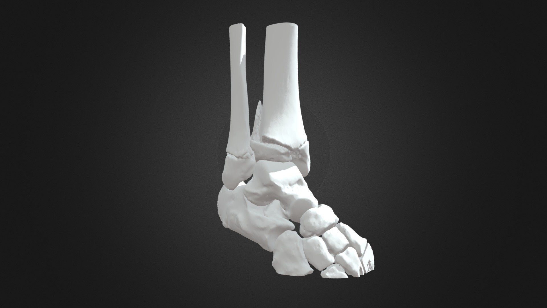 Triplane Fractures - 3D model by yuhuihuang [66e738d] - Sketchfab