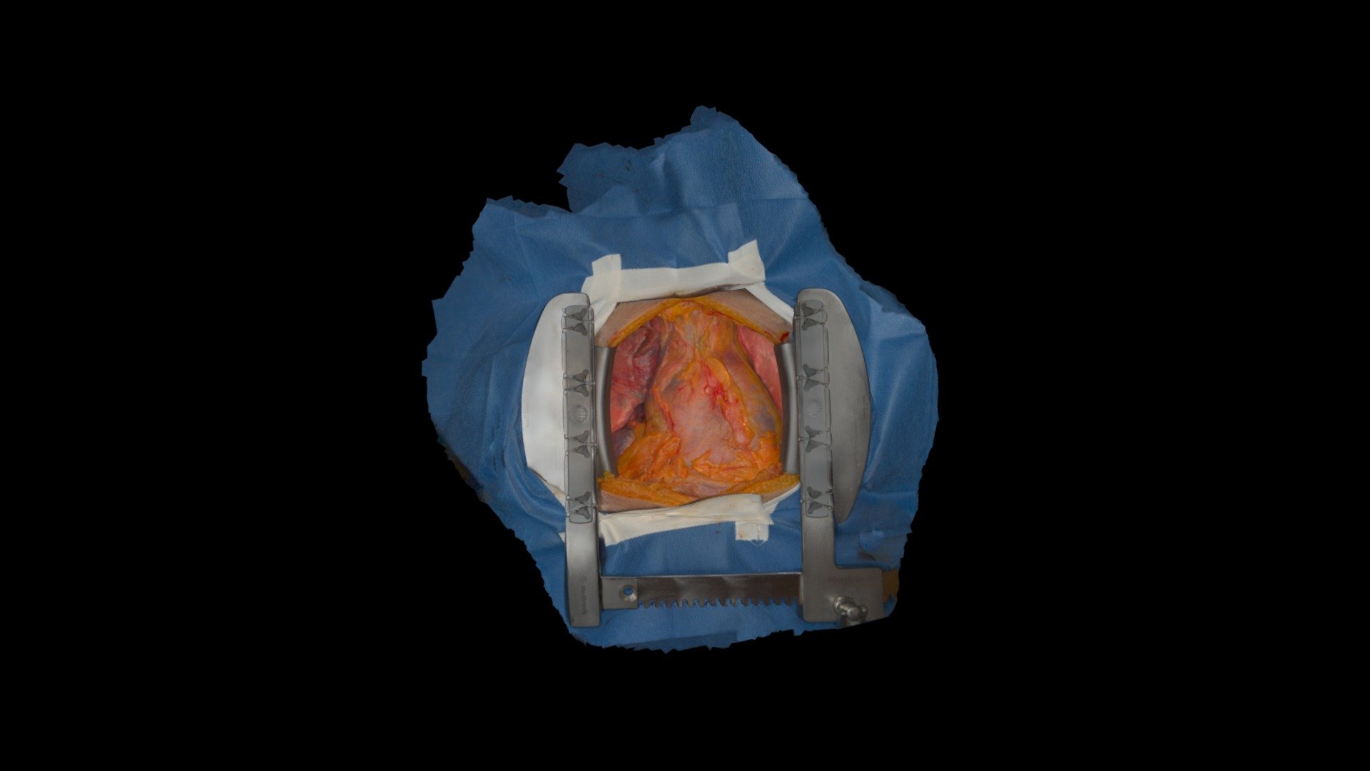 Cadaver Dissection Step 3: Lungs Deflated - 3D model by ...