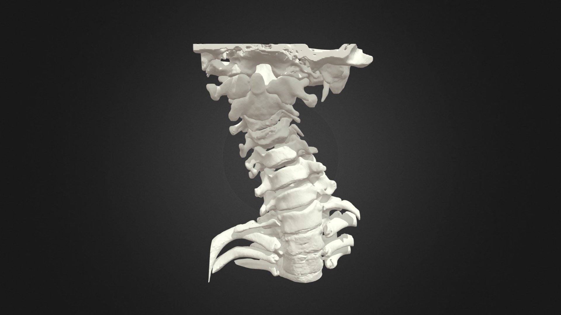 C-Spine Segmentation Anomalies - 3D model by yuhuihuang [67d691f ...