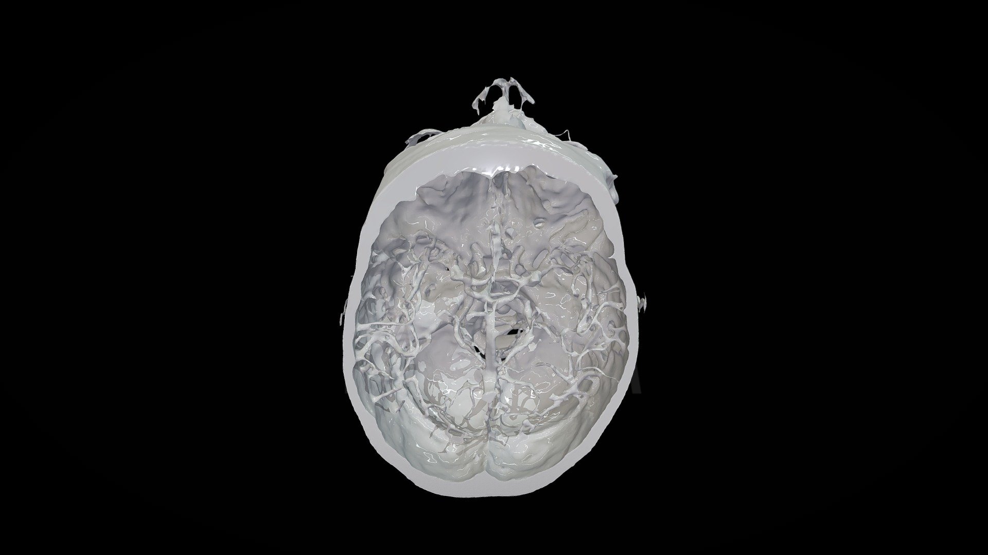 KCAS - Ant Comm Aneurysm + MCA - 3D model by Dr. Samuel Damin (@sdamin ...