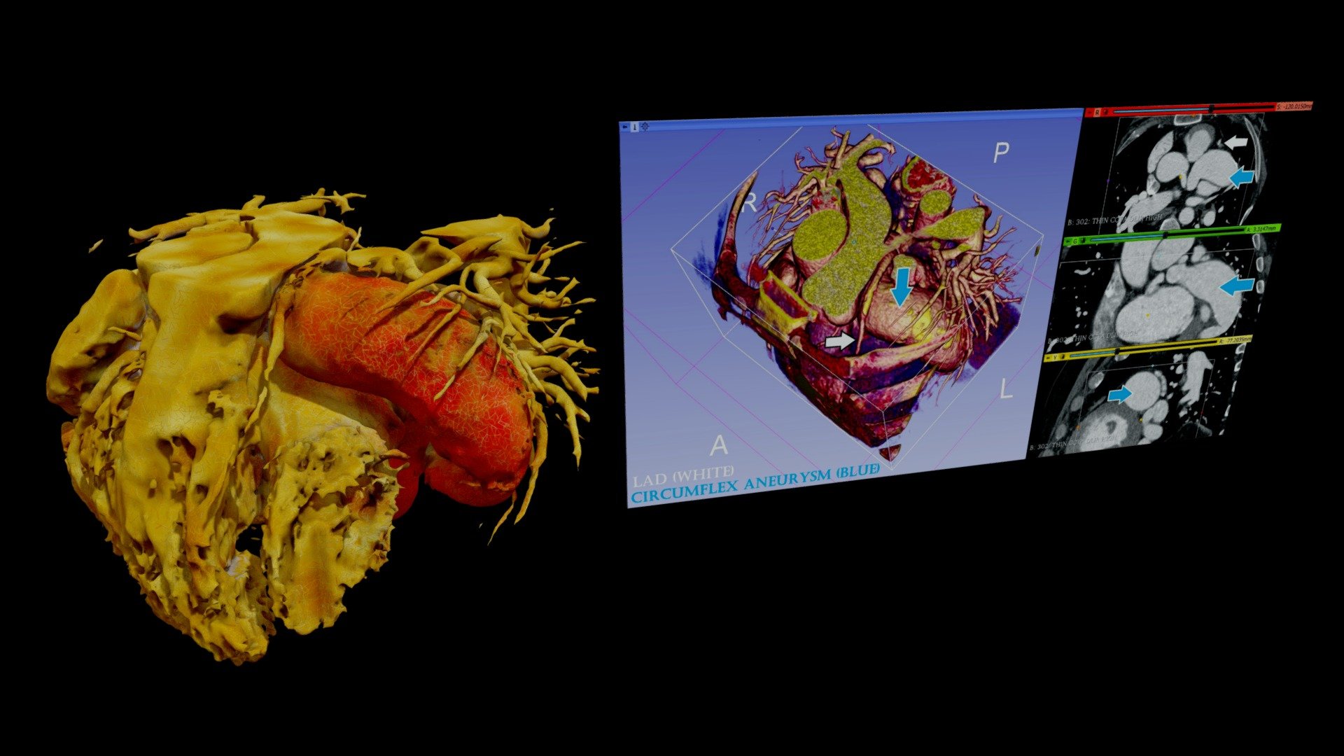 Circumflex Coronary Artery Aneurysm - Download Free 3D model by tl0615 ...