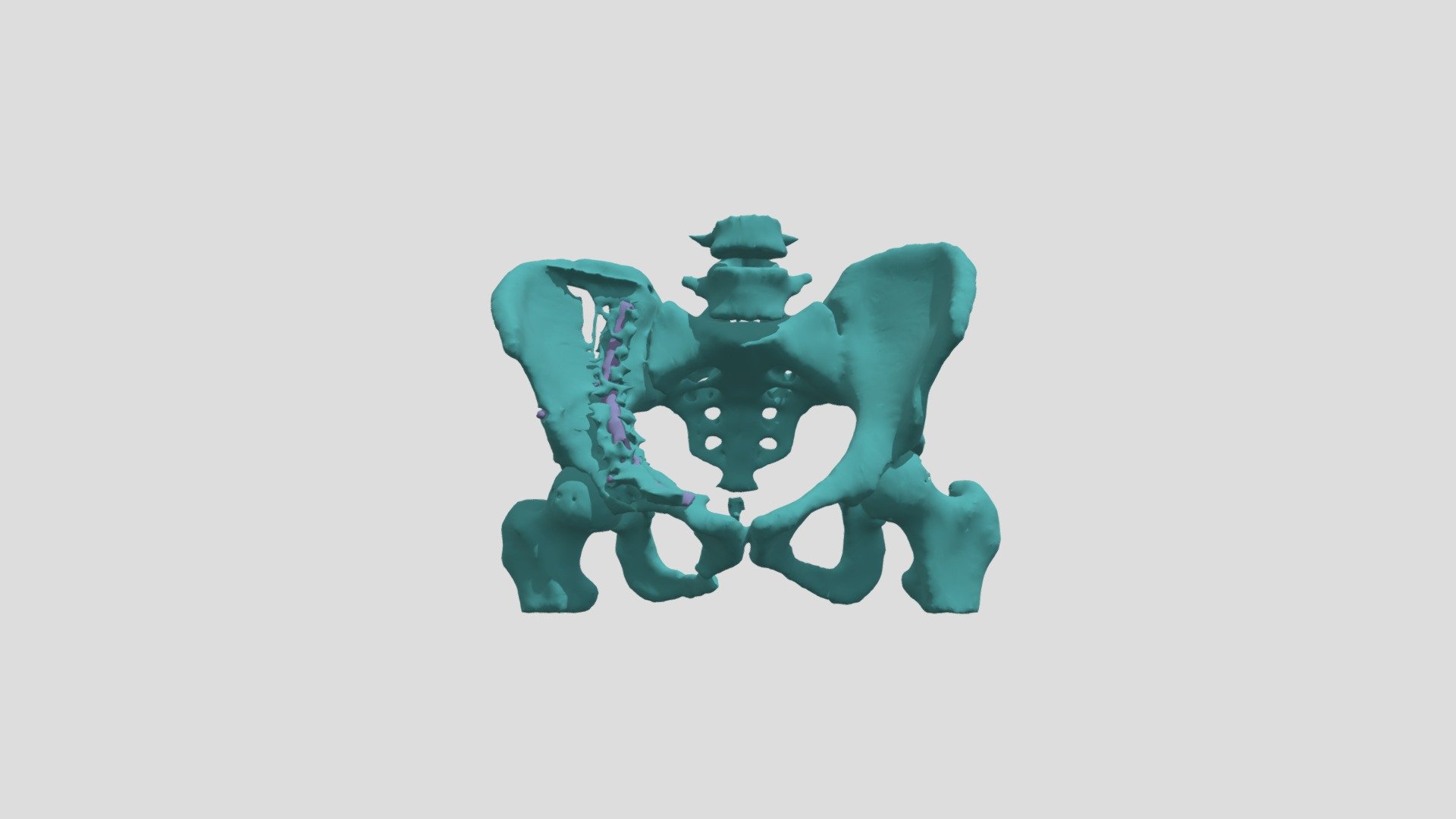Fractured Pelvis with Hardware - Download Free 3D model by quinlancuddy ...