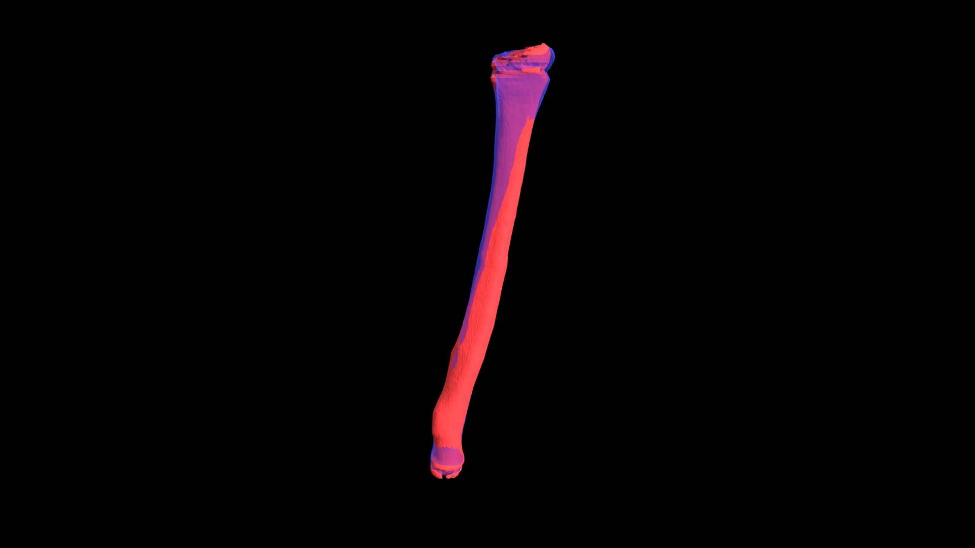 Forearm deformity overlay RADIUS - 3D model by Lincoln Wong ...