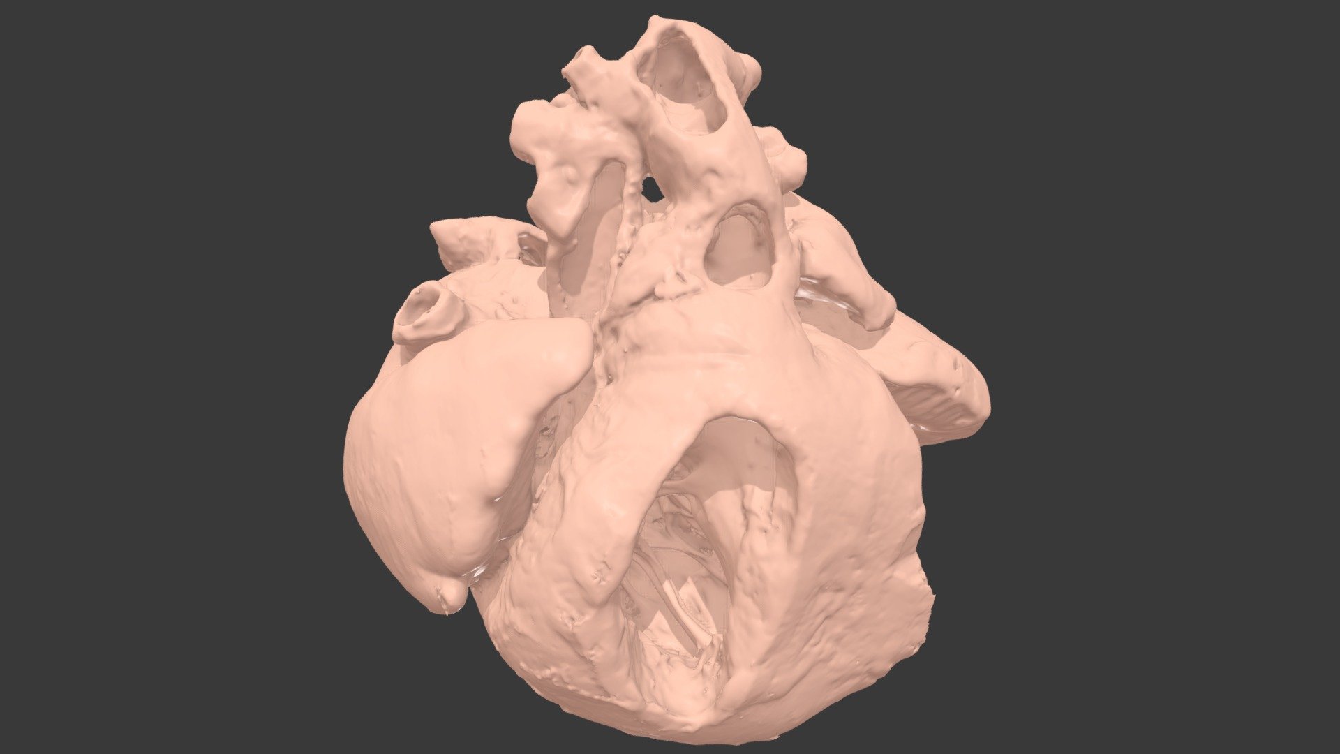 PDA #2 - {S,D,S} with PDA, ASD2, and BAV - 3D model by heartmodels ...
