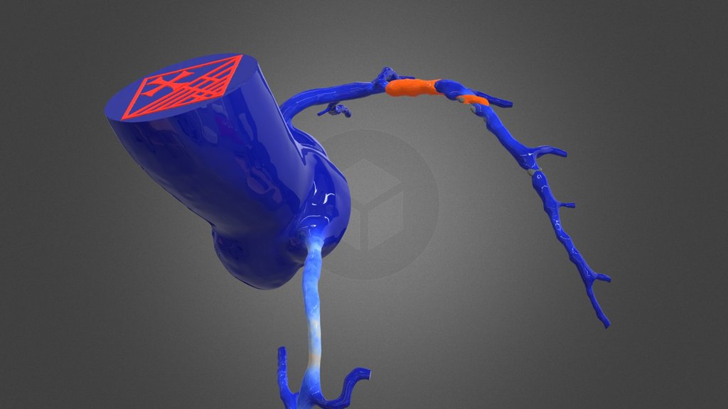 Coronary artery disease - A 3D model collection by Abdel Hakim Moustafa ...