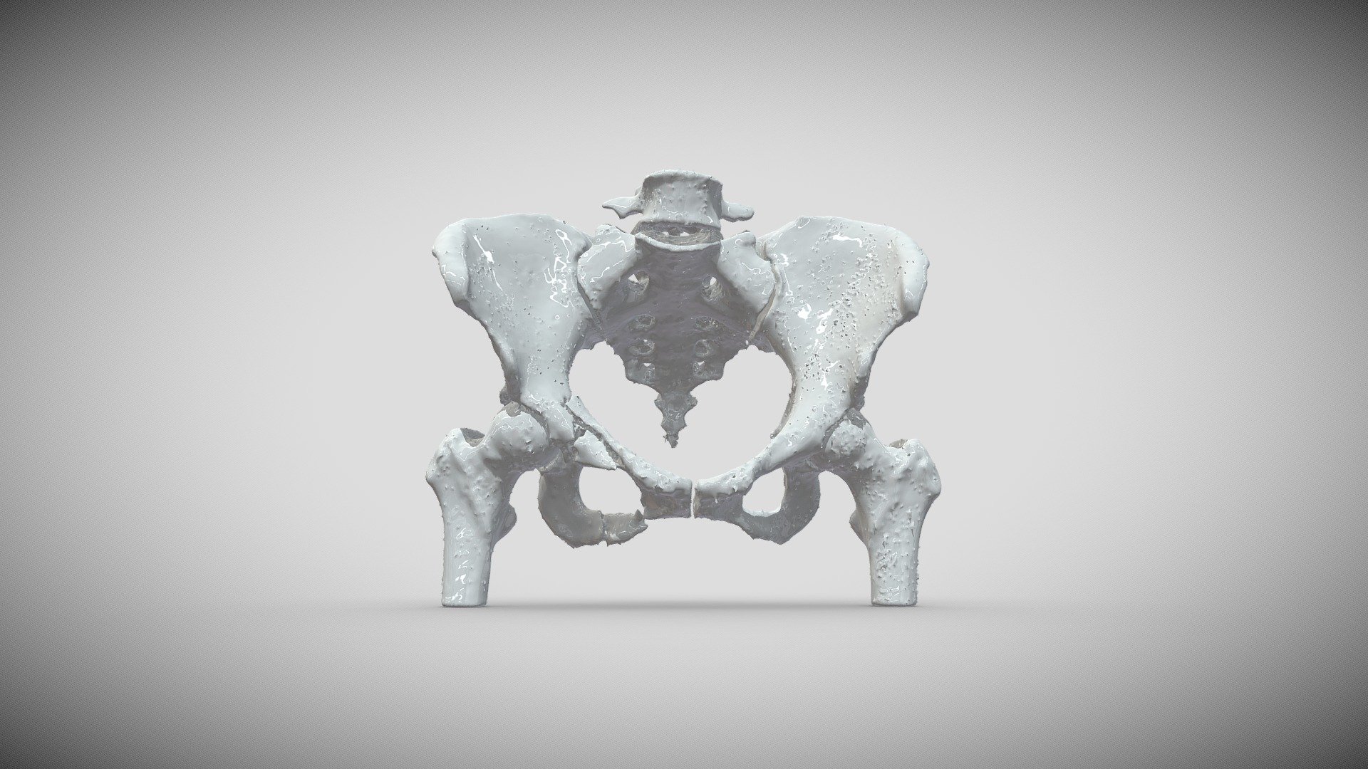 Pelvis Fracture - Buy Royalty Free 3D model by Dr. Samuel Damin ...