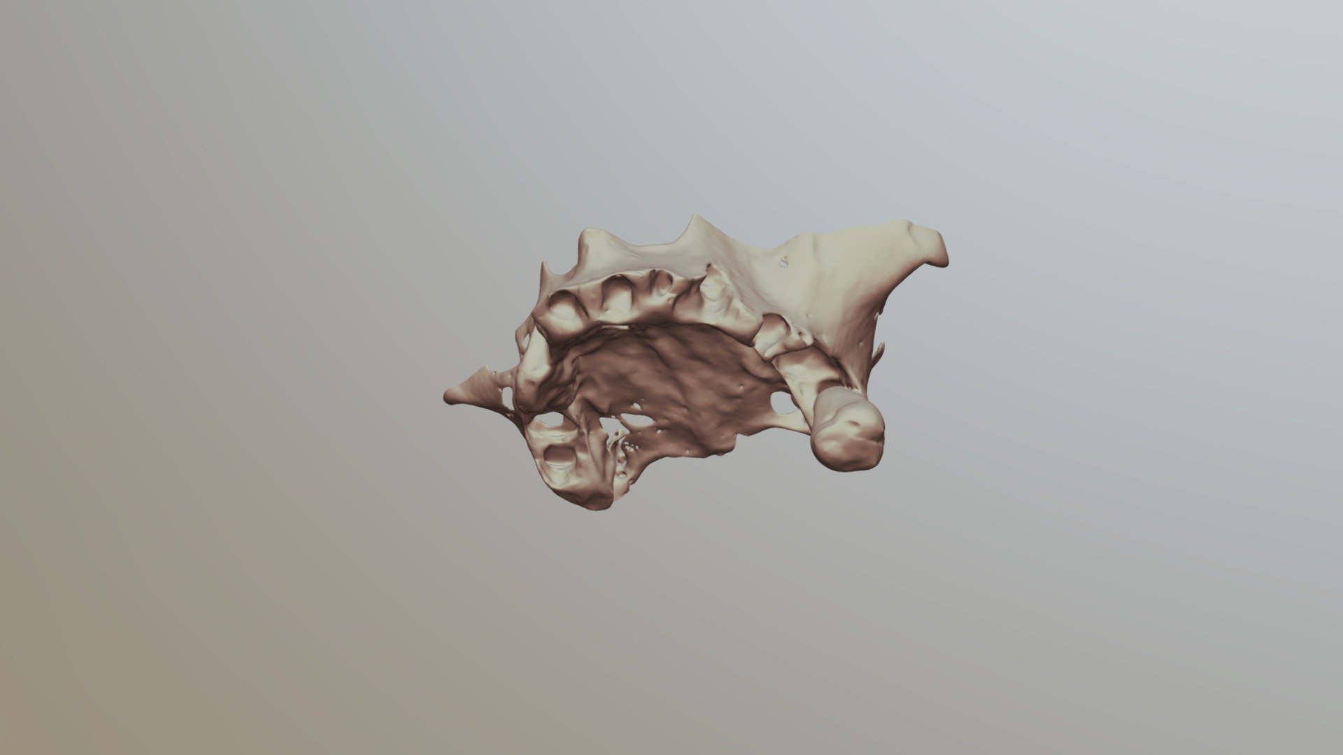 Osso Mascellare - 3D model by 3Dsurgery [6bfb192] - Sketchfab