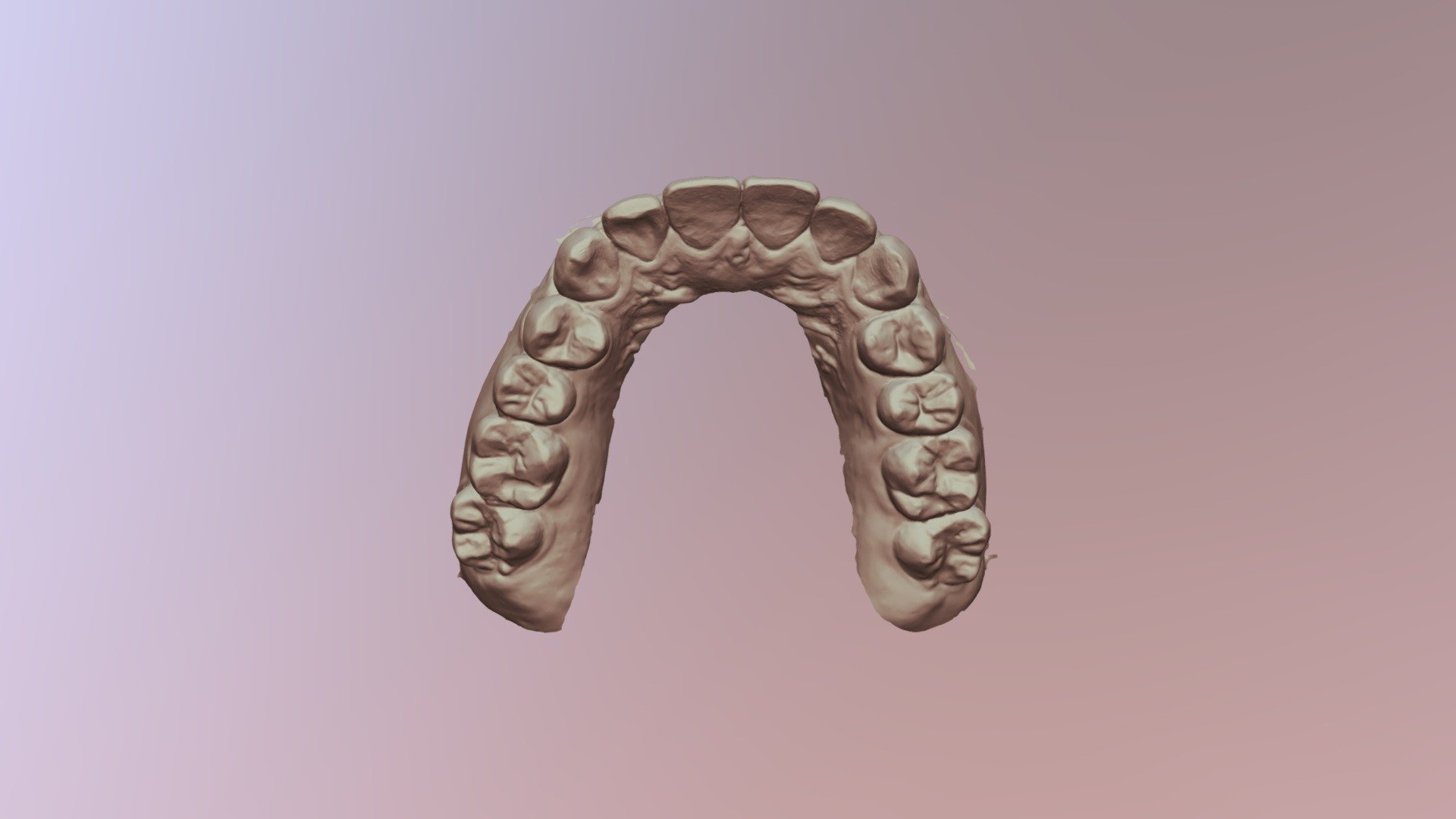 Upper Pre Preparation Scan - 3D model by wawayu99 [6c1eab8] - Sketchfab