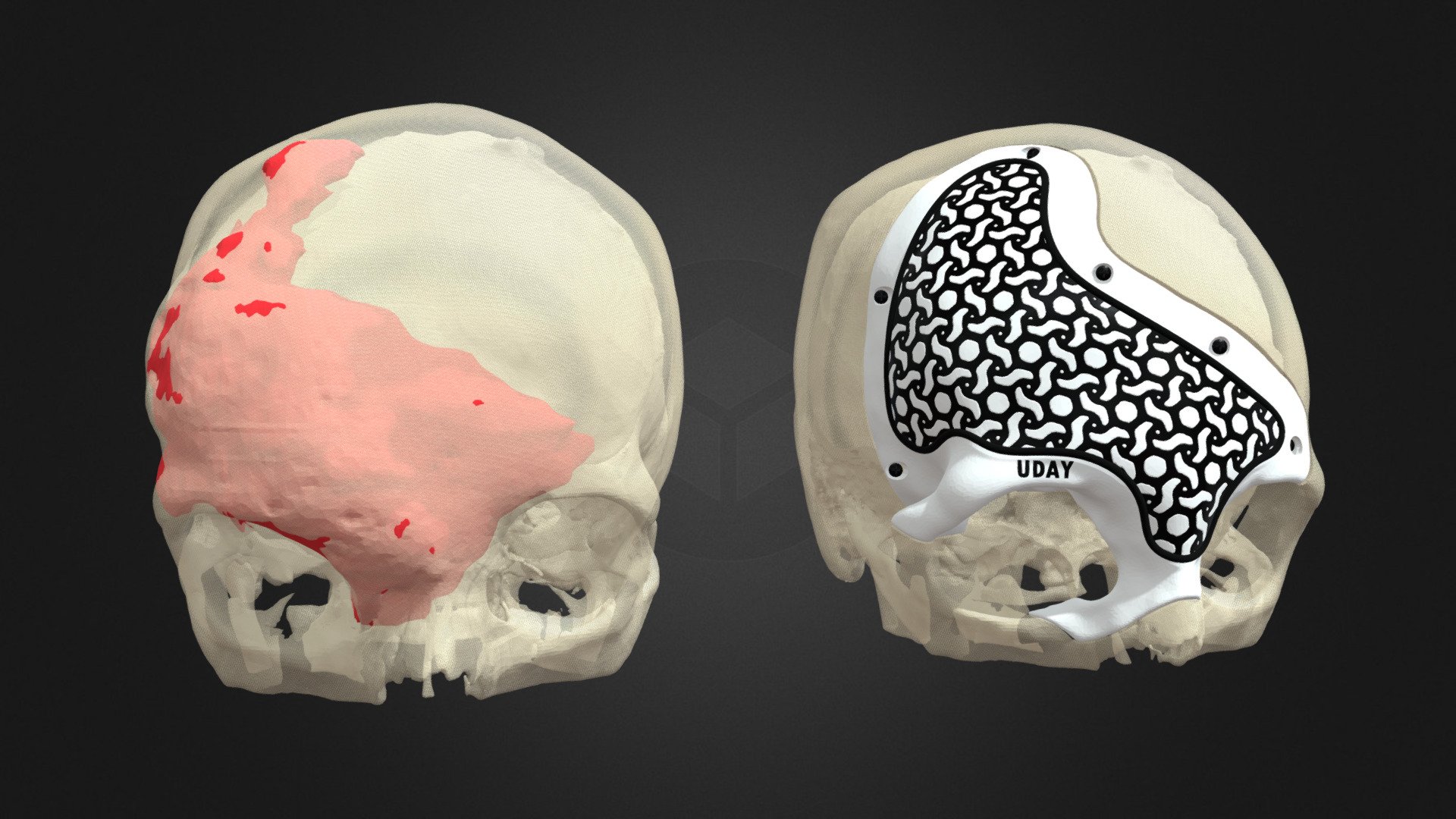 Skull tumour and prosthesis - 3D model by johnnyuday [6d07038] - Sketchfab