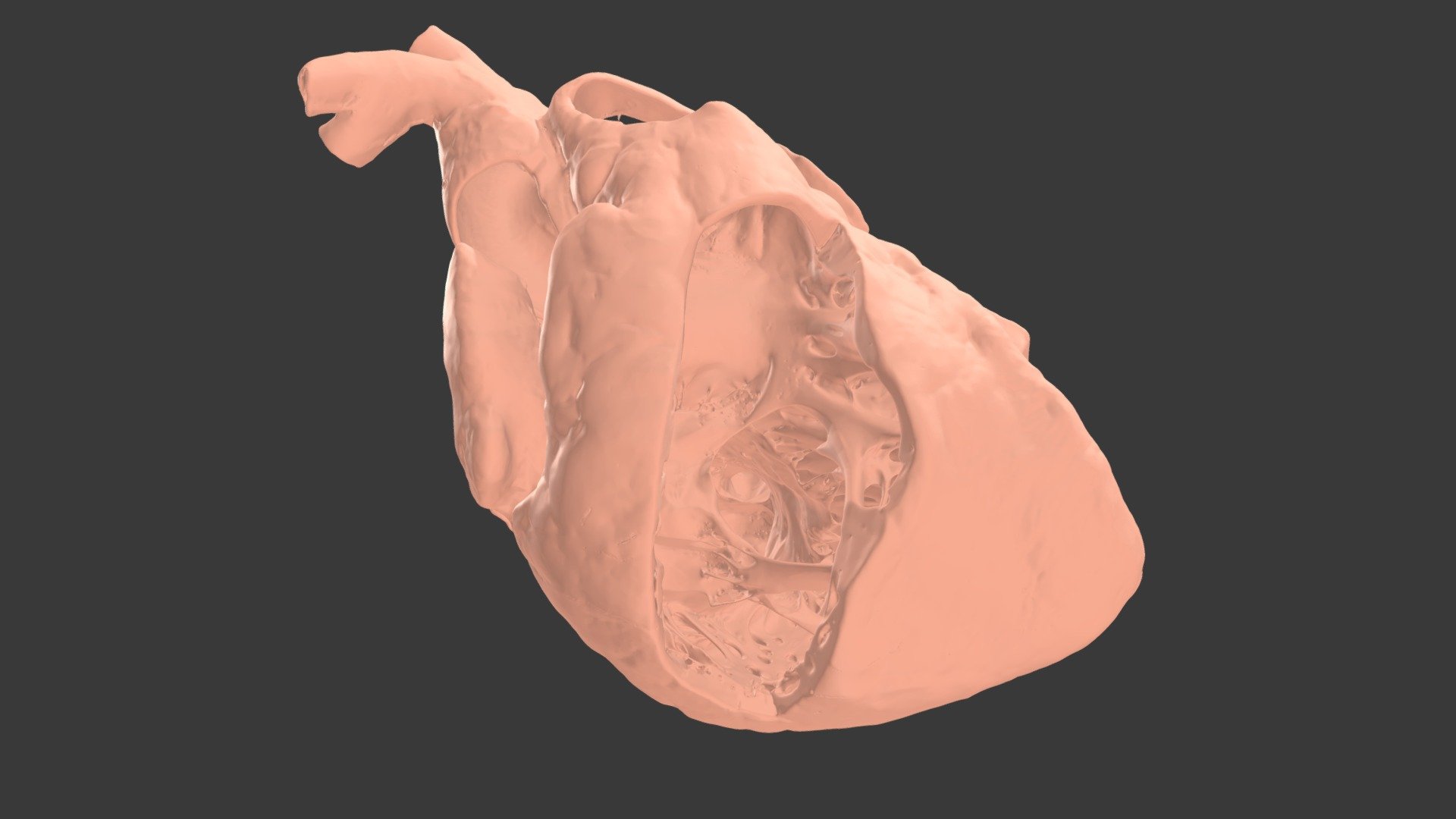 Surgery #1 - Normal heart {S,D,S}, s/p Senning - 3D model by ...