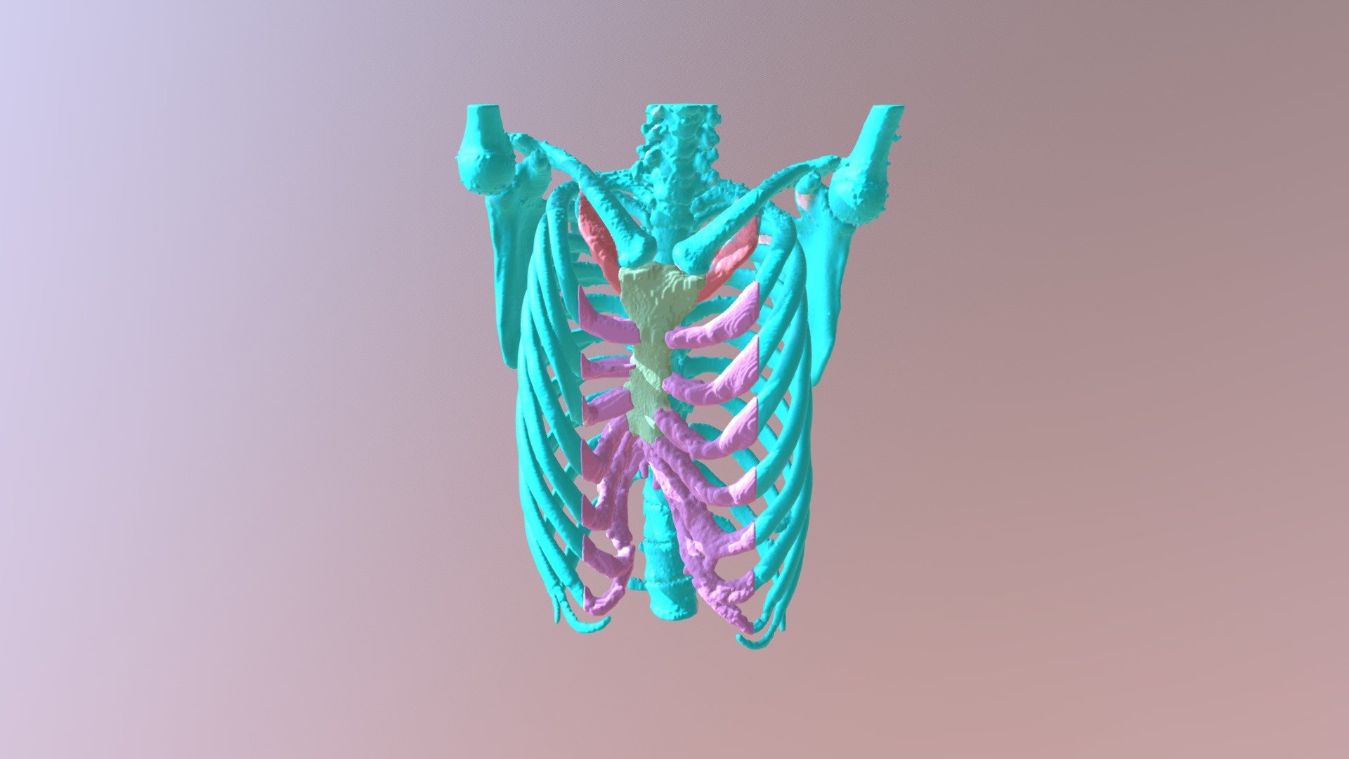 Severe Pectus Excavatum - 3D model by dontchangela [6d82fb8] - Sketchfab