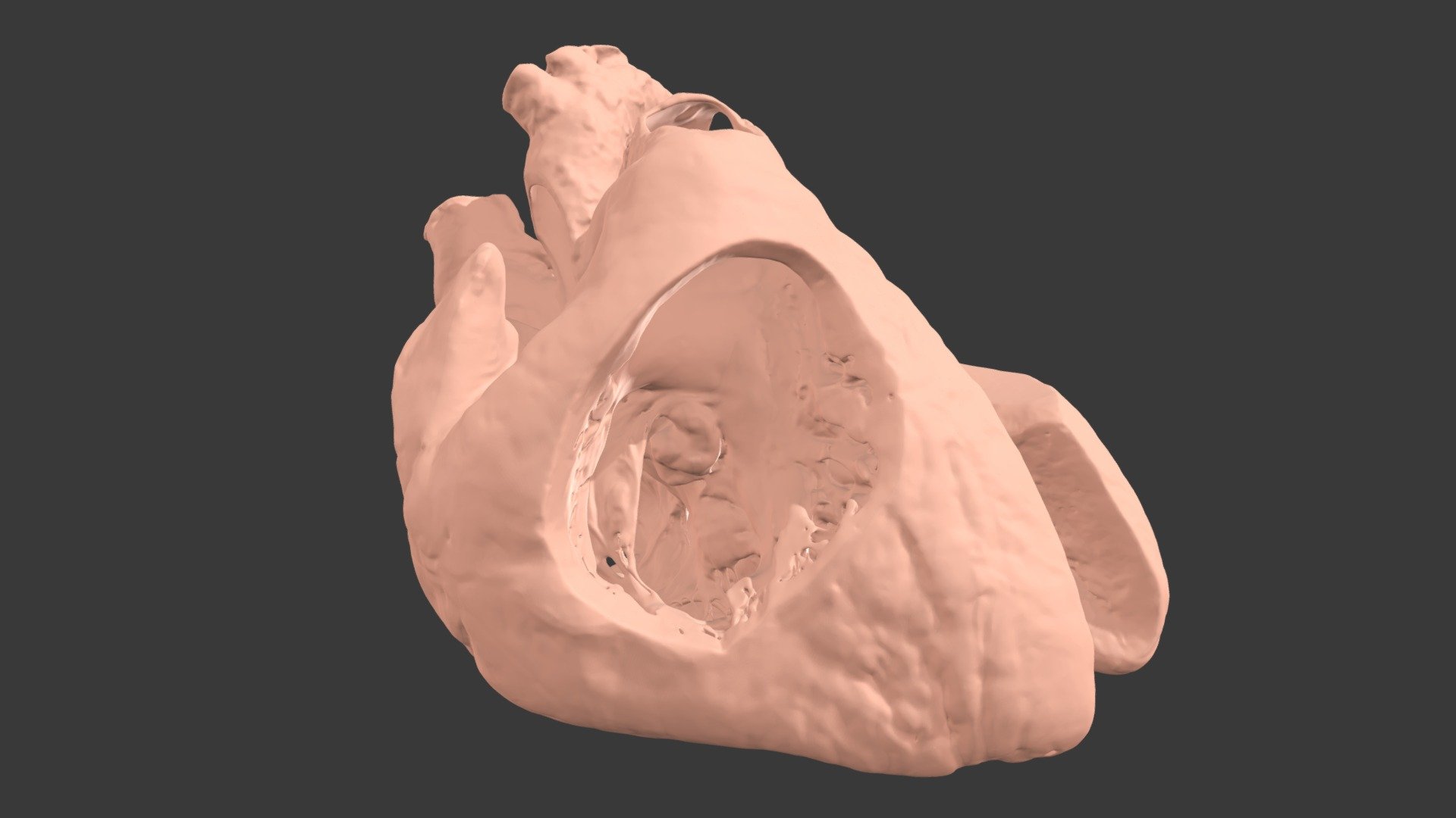 VSD #2 - {S,D,S} with VSD aneurysm - 3D model by heartmodels [6d8f2e2 ...