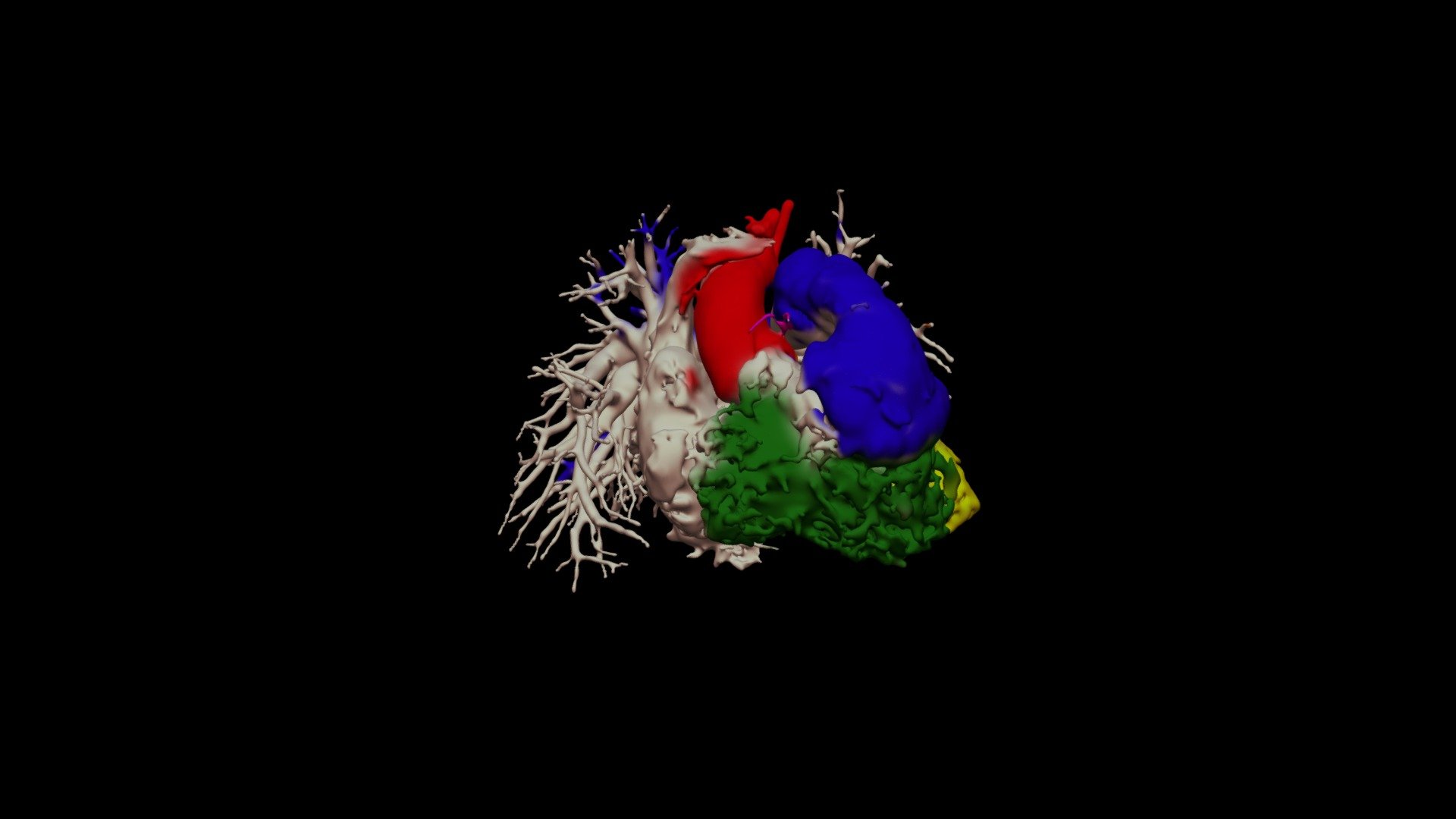 Pulmonary Atresia S/P Conduit Repair - Download Free 3D model by jonbra ...