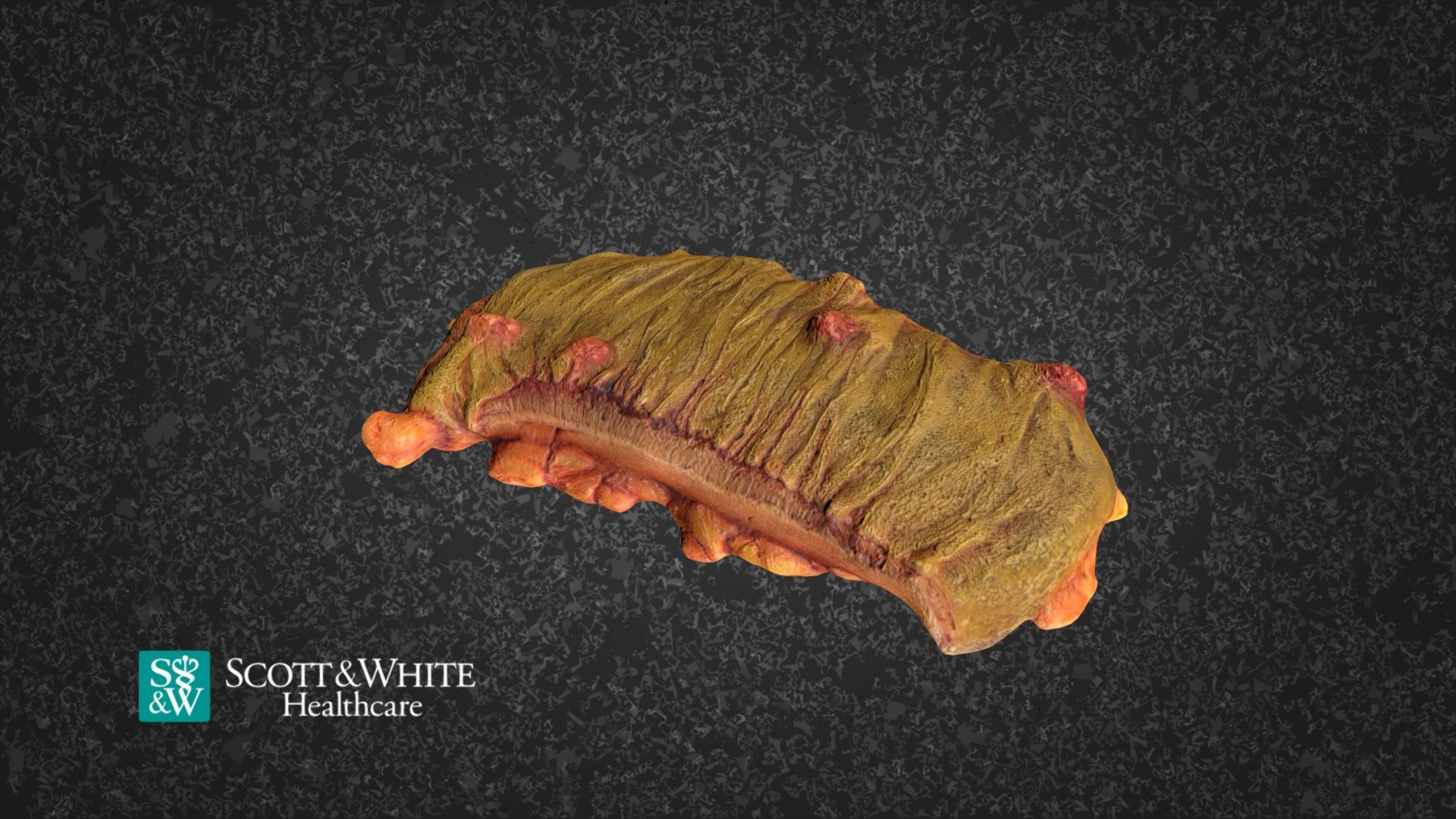 Sigmoid Mult Sessile Polyps 301816 - 3D model by Scott & White Moulage ...