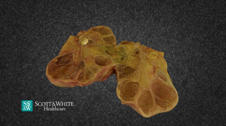 Kidney Hydronephrosis Pyelonephritis 316391 - 3D model by Scott & White ...