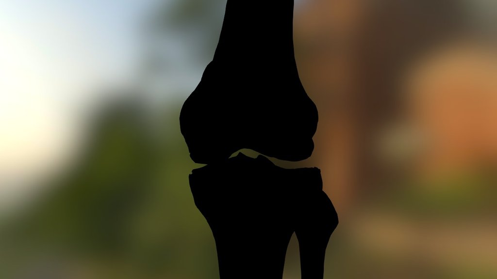 Knee - Proximal Tibia Fracture sku 030 - 3D model by orto3d [6f7ef71 ...