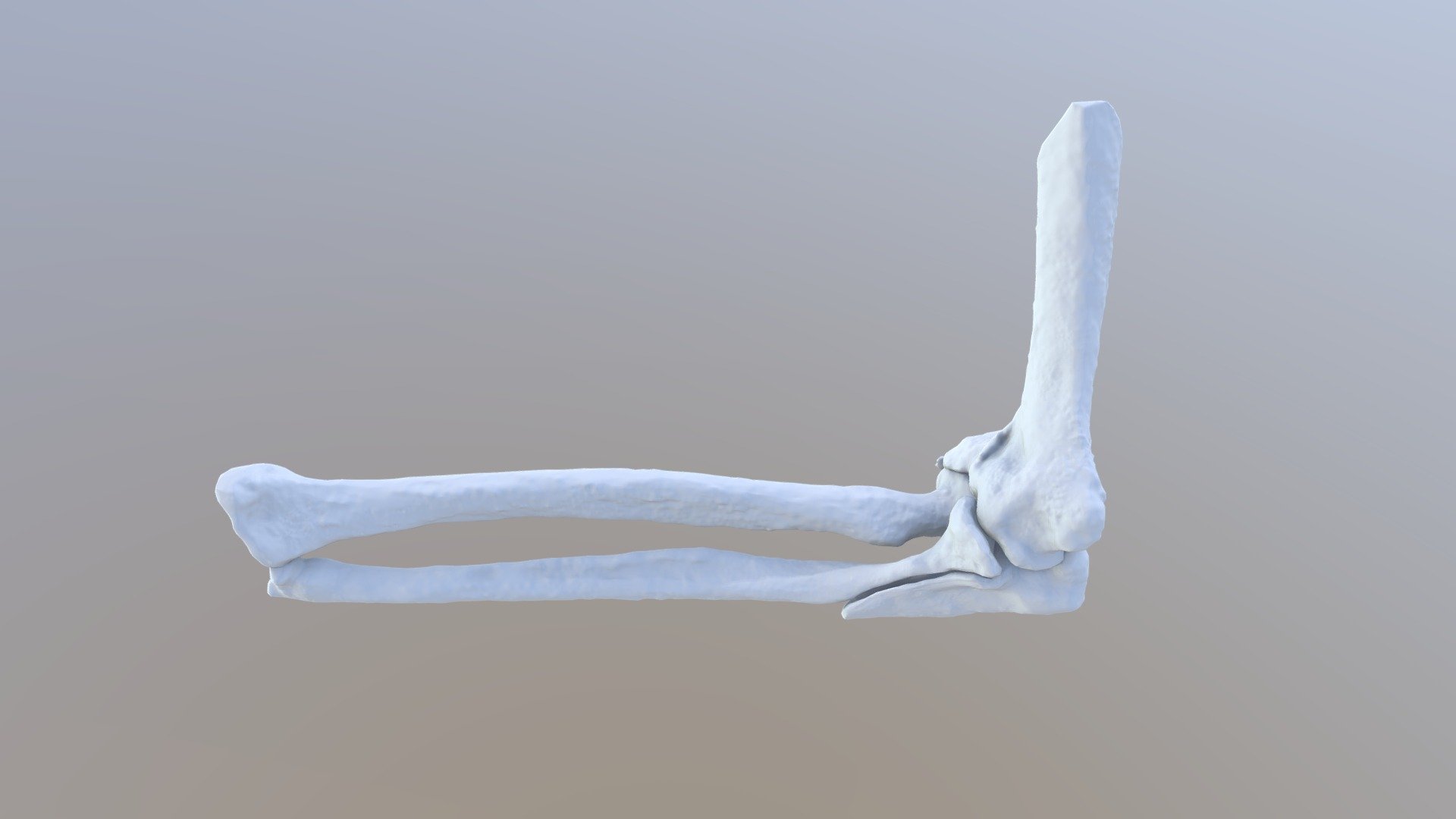 Distal humerus fracture (18.08 SH) - 3D model by Innowise: VOKA Trauma Pathologies 3D Catalogue ...