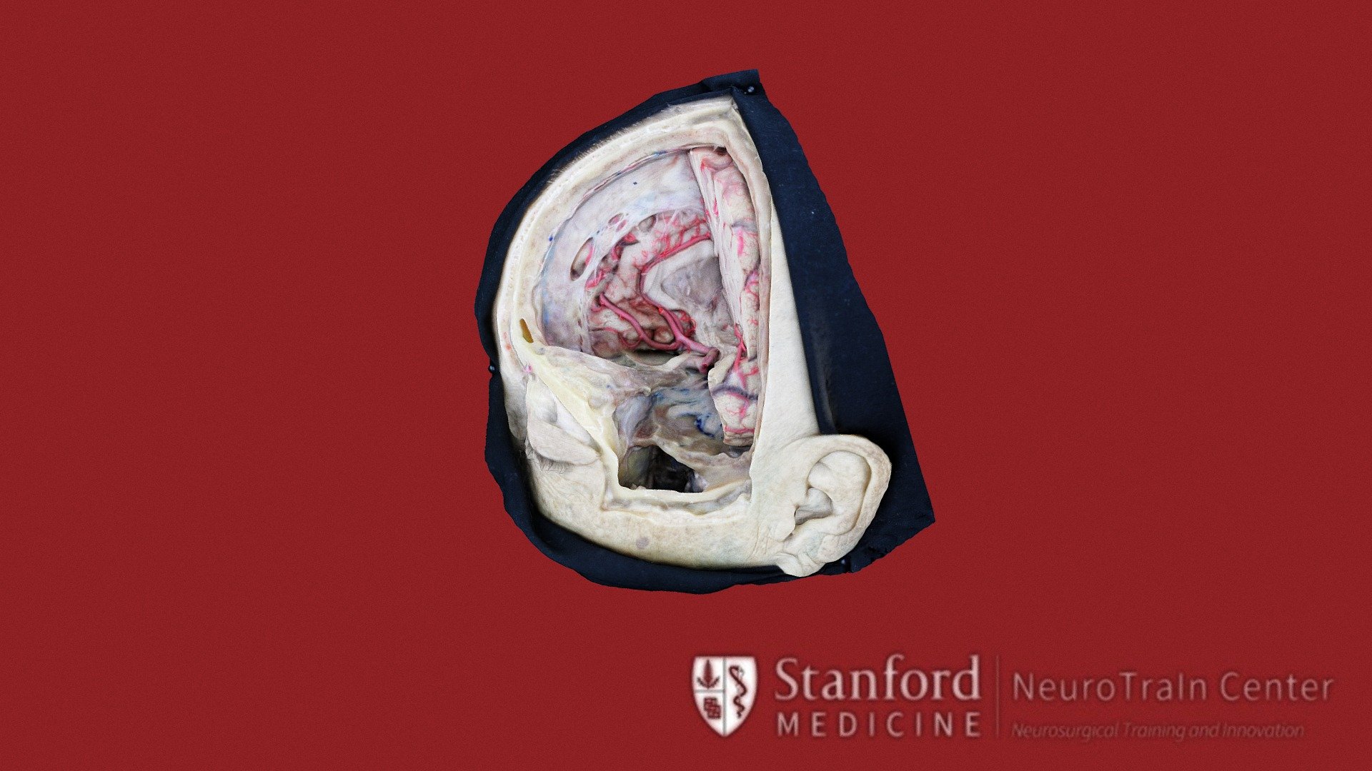 Craniotomy - Step 3 - 3D model by vv (@verav) [6fa1530] - Sketchfab