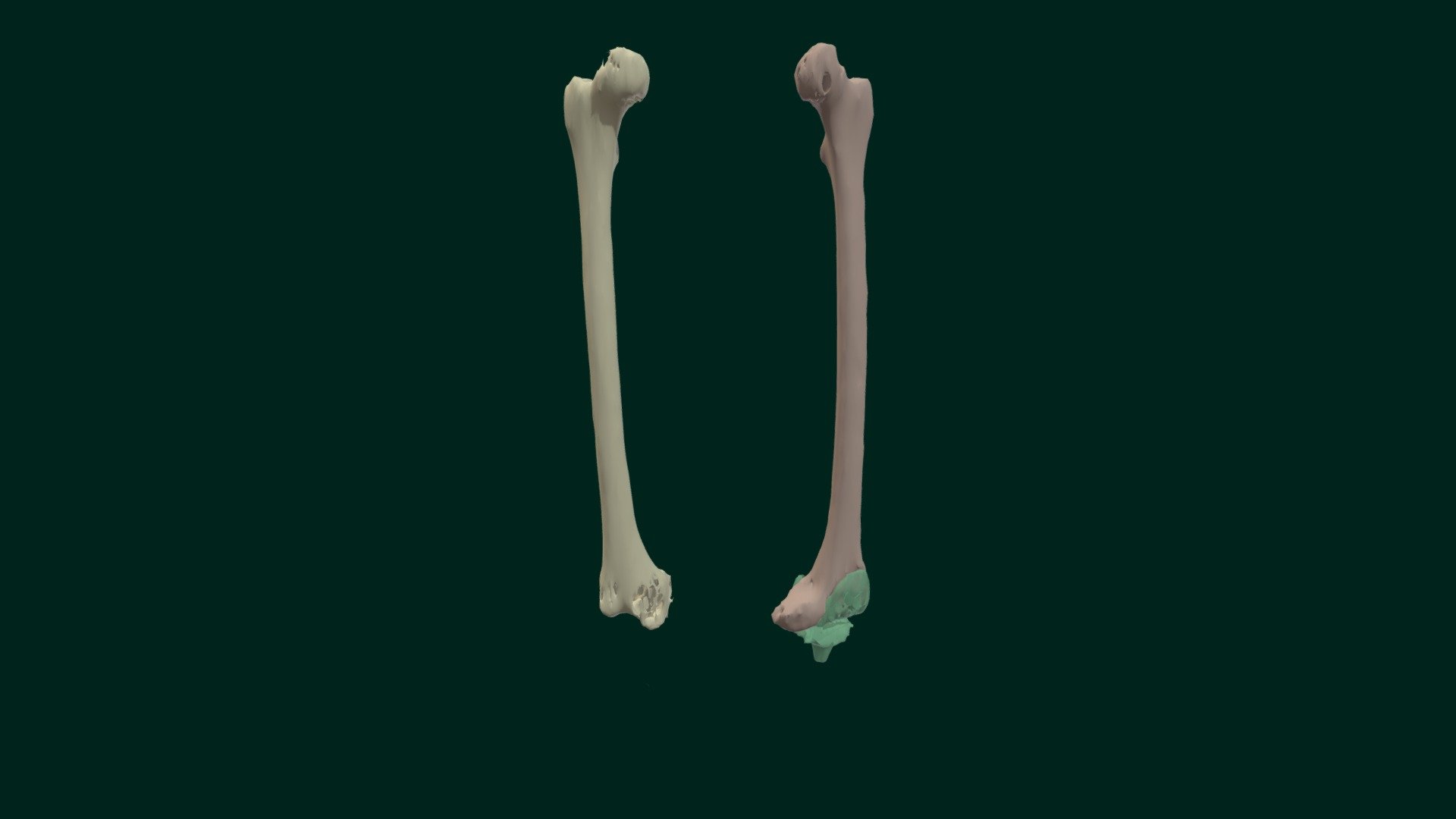Right/Left Femur and Implant - Download Free 3D model by kaco6446 ...