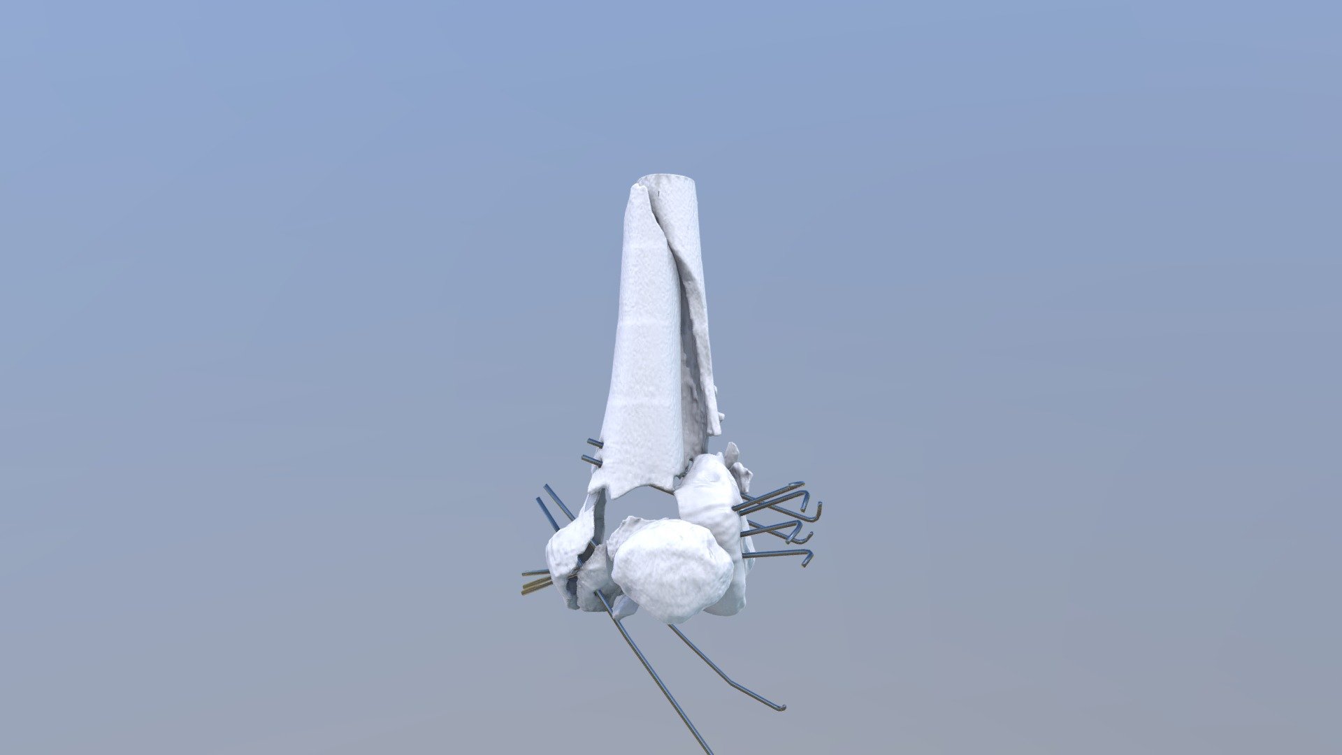 Open comminuted intraarticular distal femoral fr - 3D model by Innowise ...