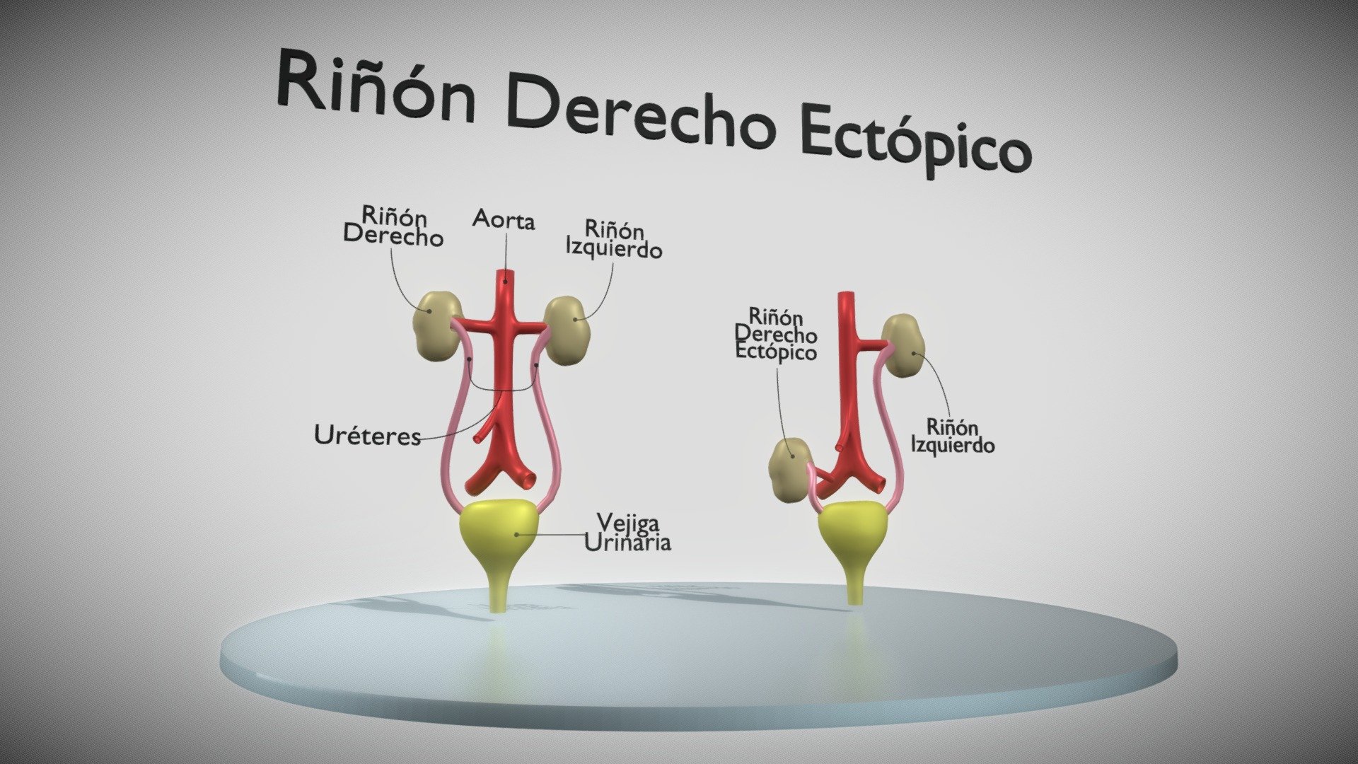 Riñón Derecho Ectópico - 3D model by Angélica Quilca (@amqmuser ...