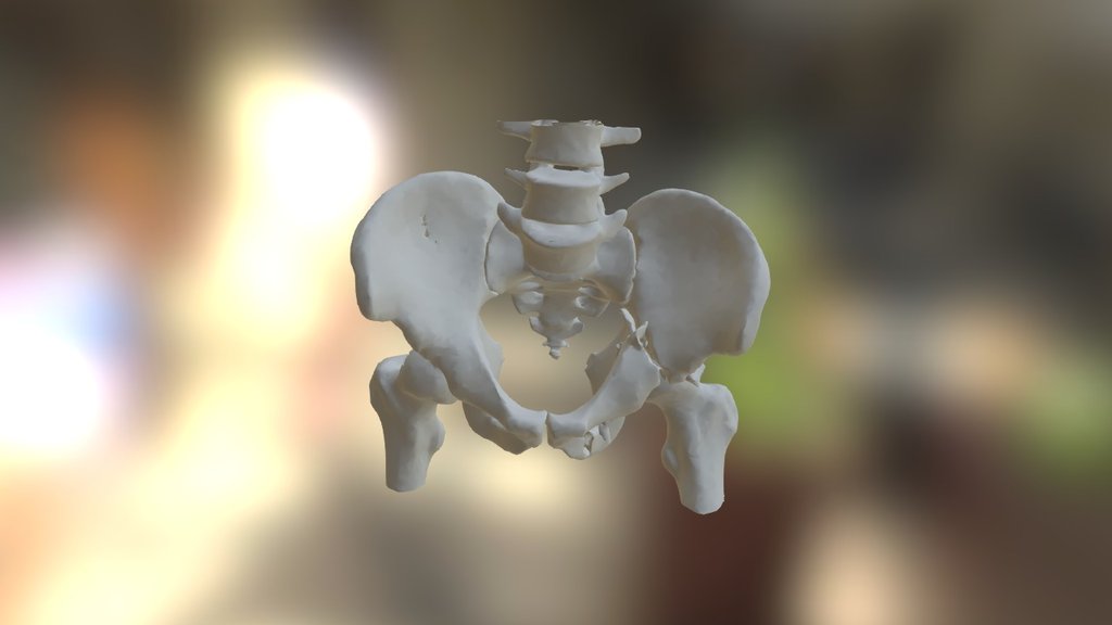 Acetabular Fracture - sku 233 - 3D model by orto3d [70d73ae] - Sketchfab