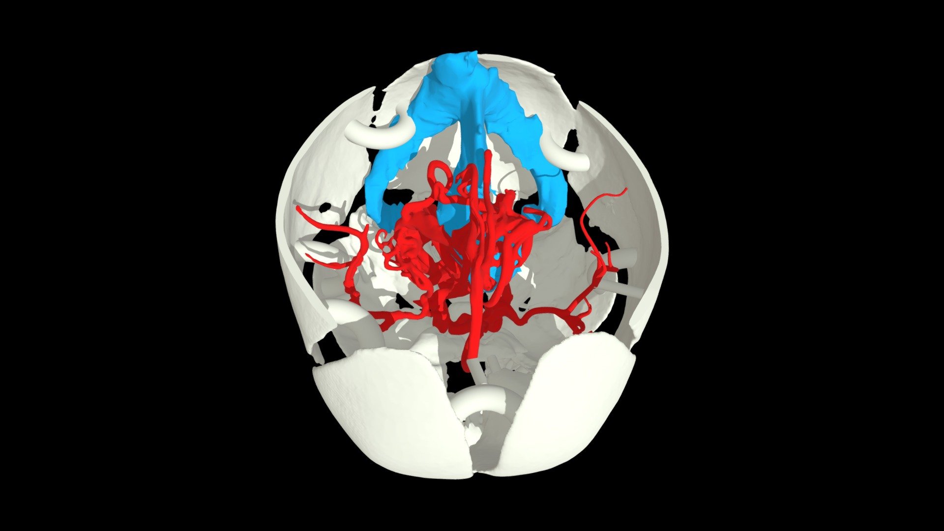 Vein of Galen Malformation - Download Free 3D model by SkullBasics ...