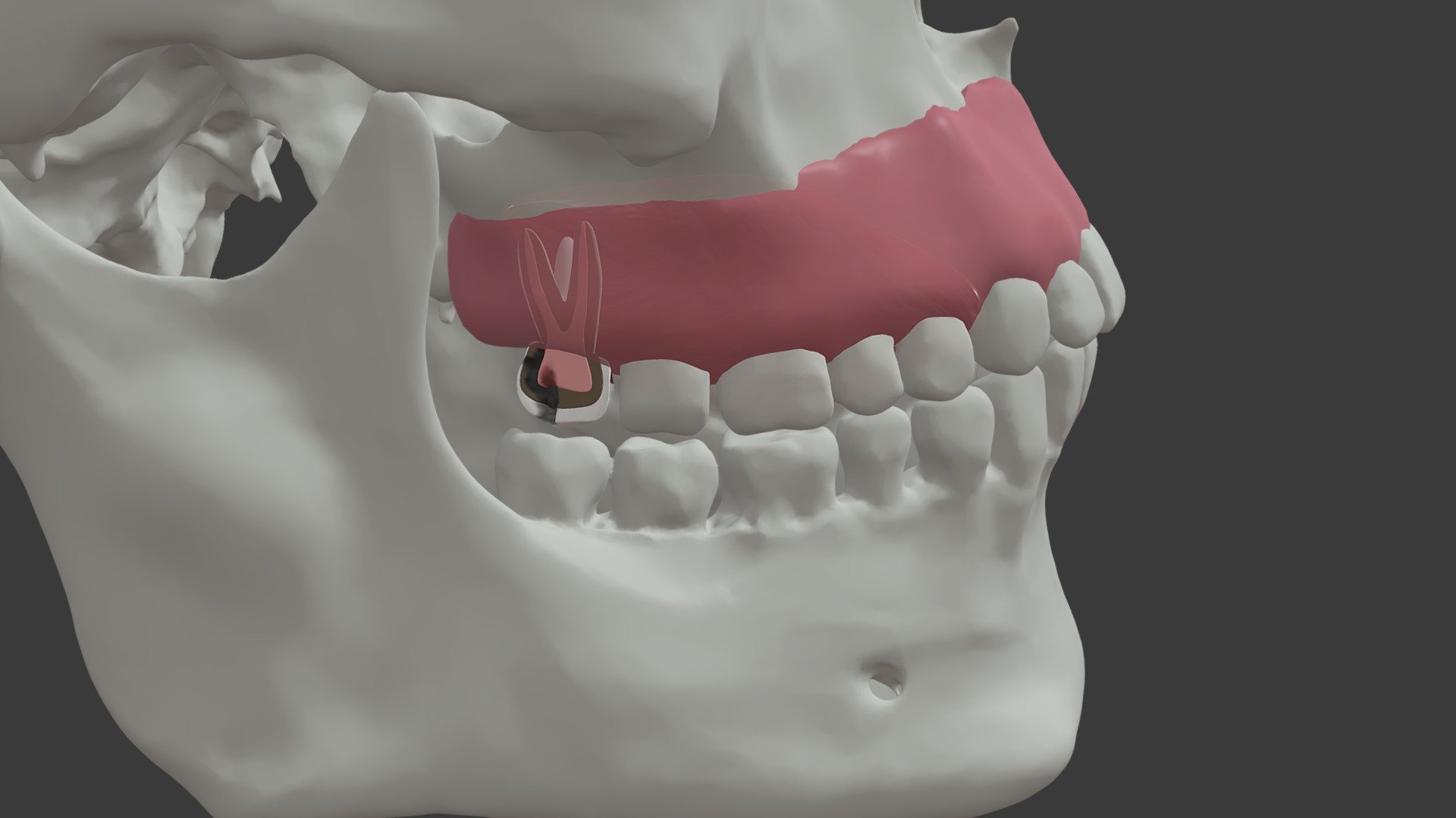 Stage 2 Long Root Maxillary Dental Infection - 3D model by University ...