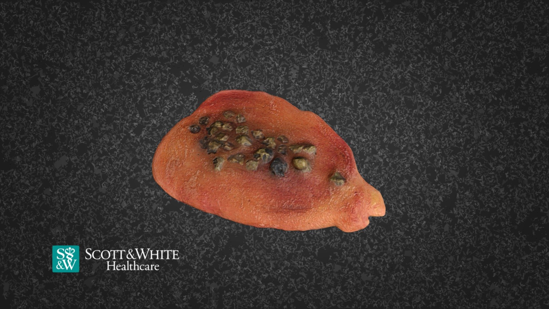 Gallbladder Black Gallstones 49413 - 3D model by Scott & White Moulage ...