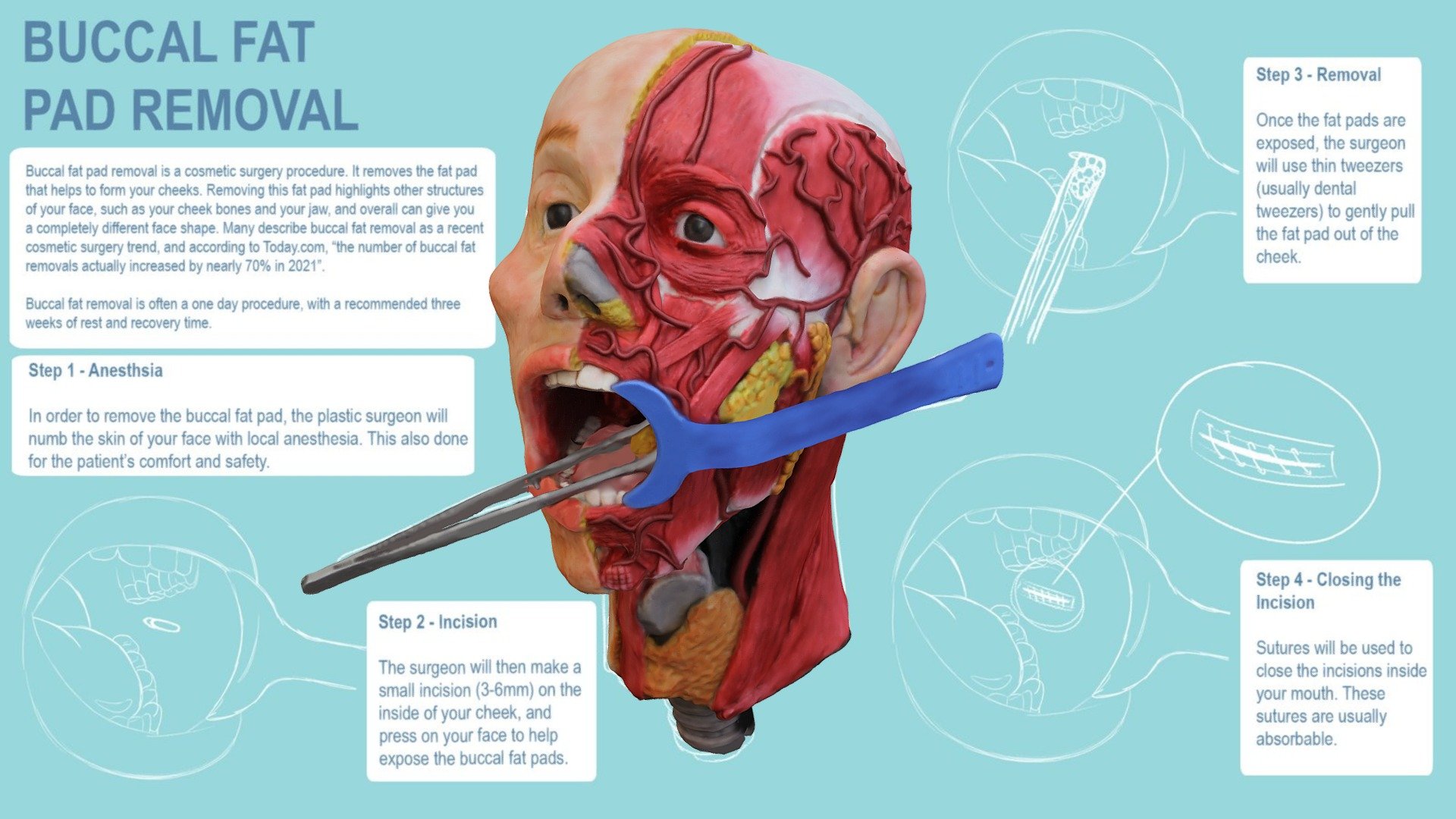 Buccal Fat Pad Removal - Wax Model - 3D model by University of Dundee ...