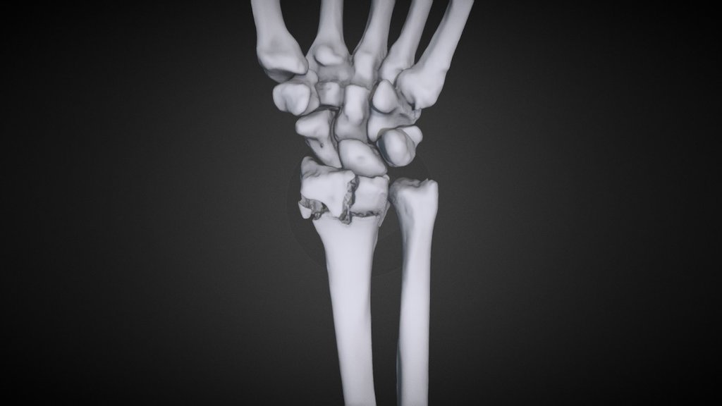 ZB-Nov17 | #4 Distal Radius (L-162513-L) - 3D model by World Surgery ...