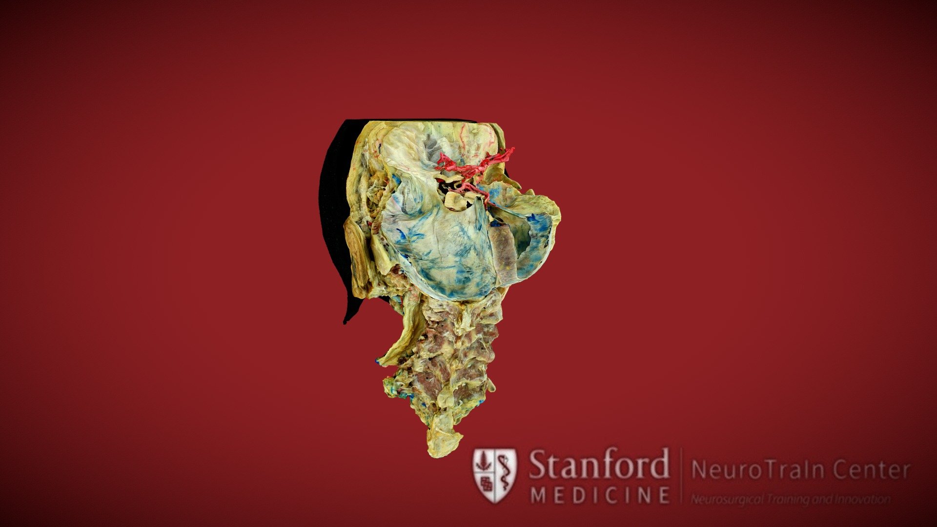 Posterior fossa and Cervical Spine - 3D model by vv (@verav) [72b5940 ...