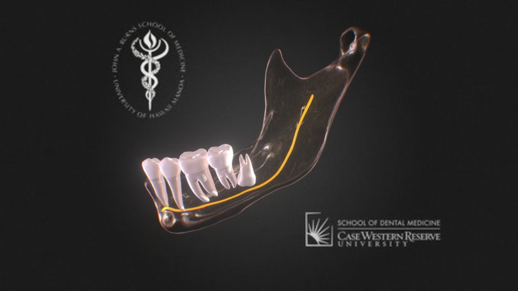 Inverted Impaction model - 3D model by John A Burns School of Medicine ...
