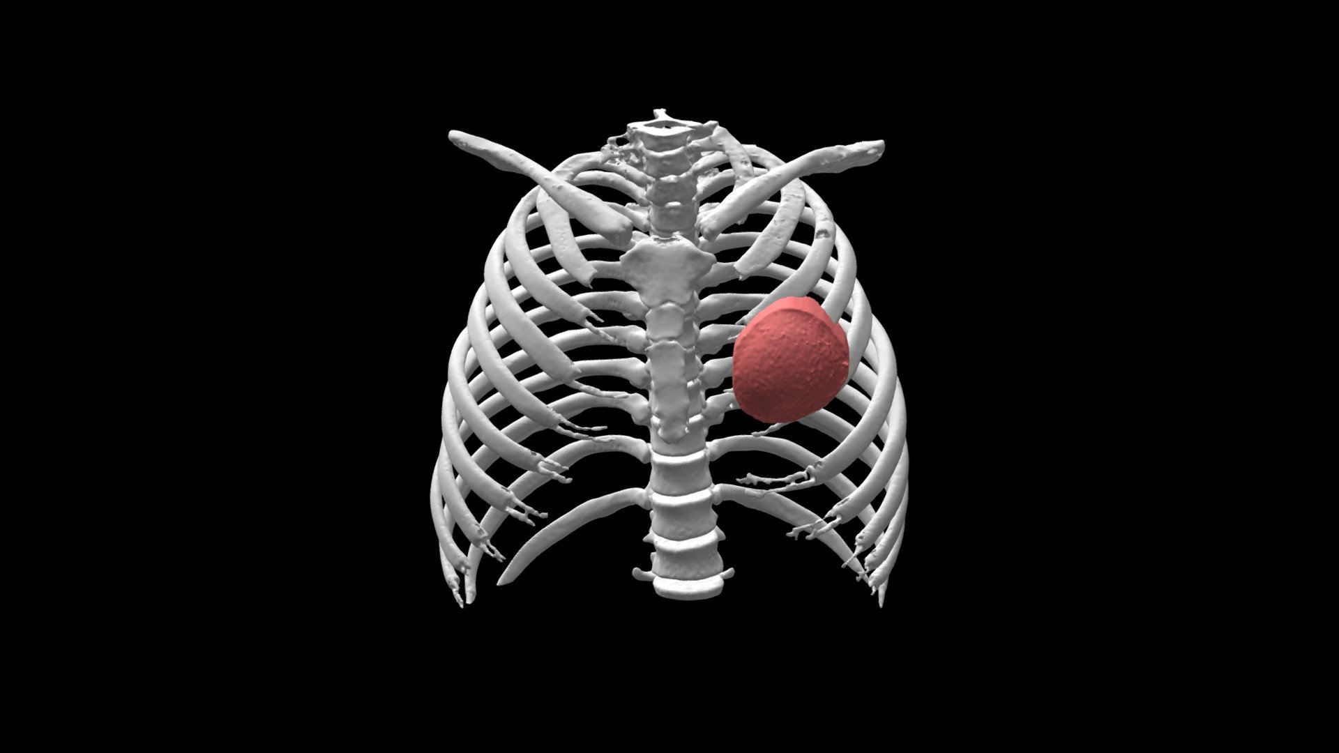 Ribcage+Tumor - 3D model by healthgate [73bc2e9] - Sketchfab