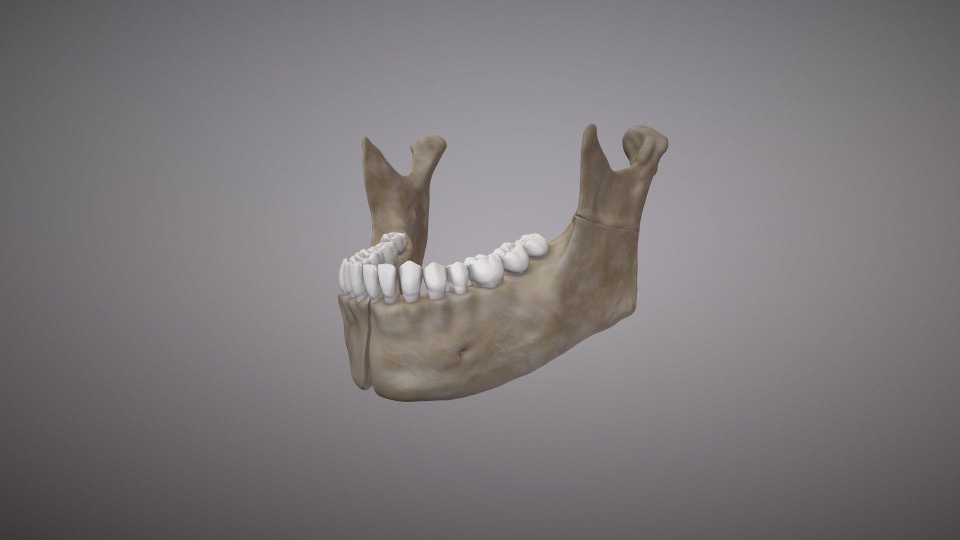 Antemortem trauma - 3D model by University of Dundee, CAHID (@anatomy ...