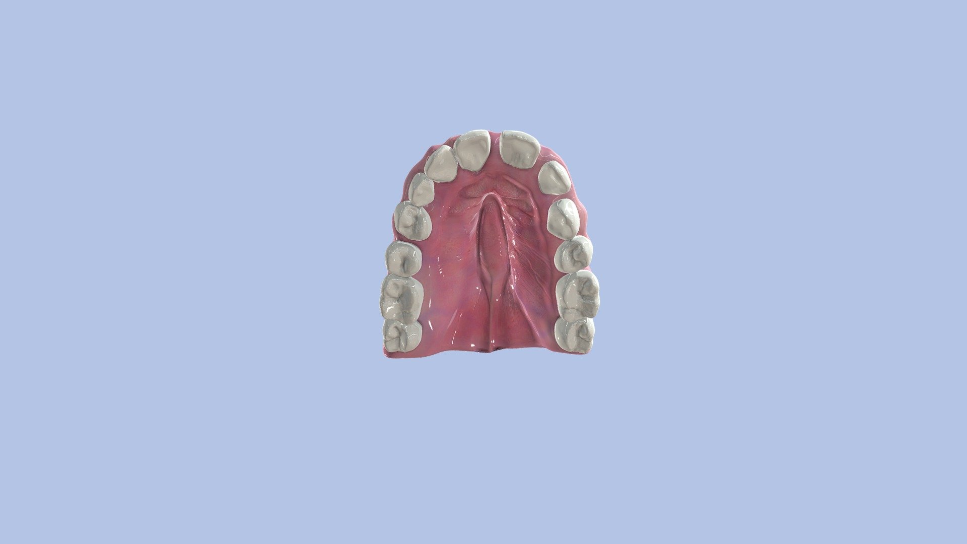 Upper Palate and Teeth of Down Syndrome - 3D model by University of ...