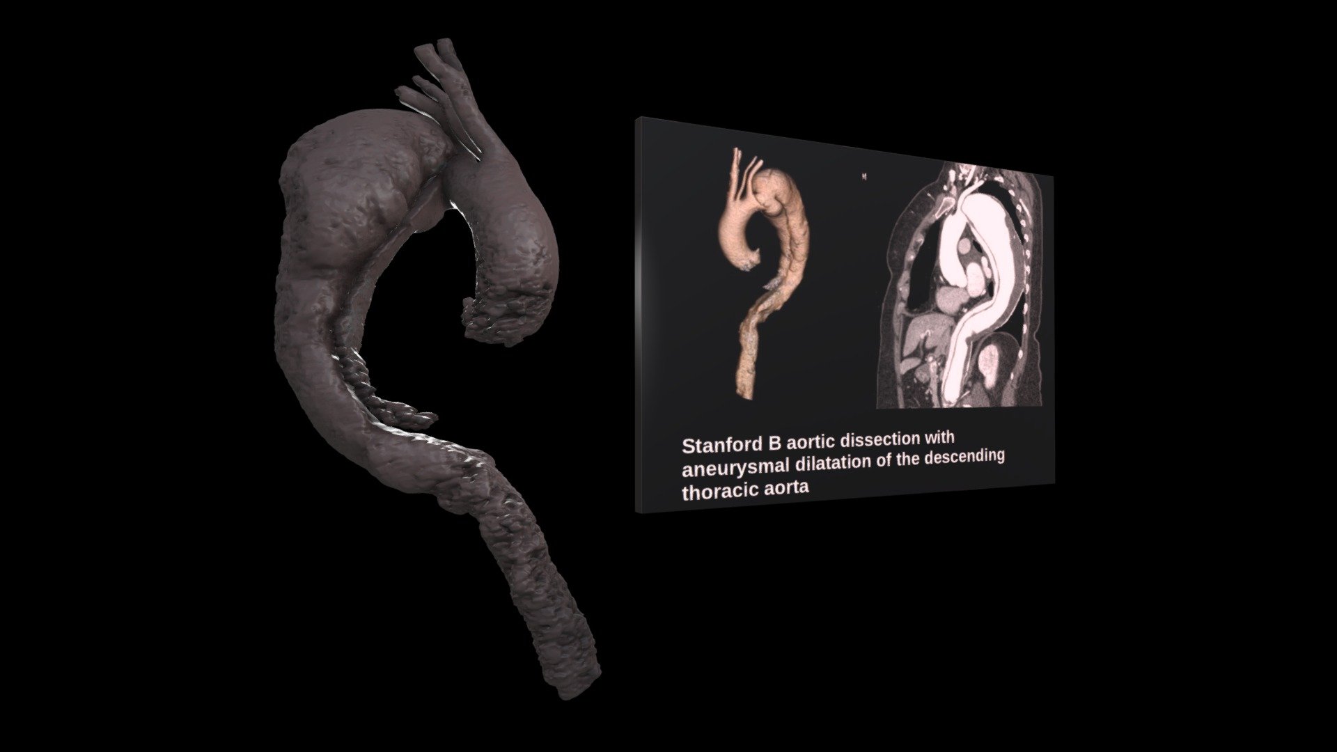 Stanford Type B Aortic Dissection 3d Model By Tl0615 [742ac0d] Sketchfab