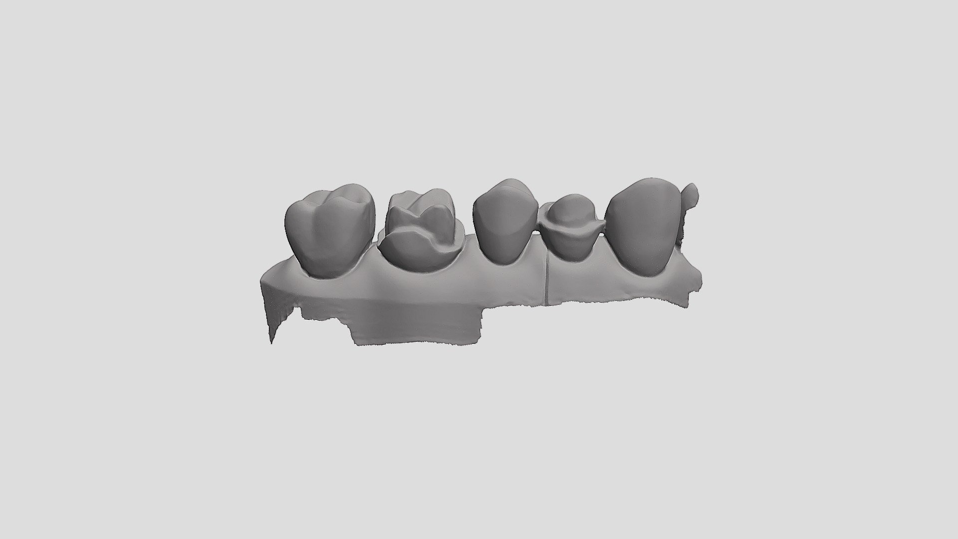 Crownlay Prep 14 with prep errors - 3D model by Tony Mennito (@mennitoa ...