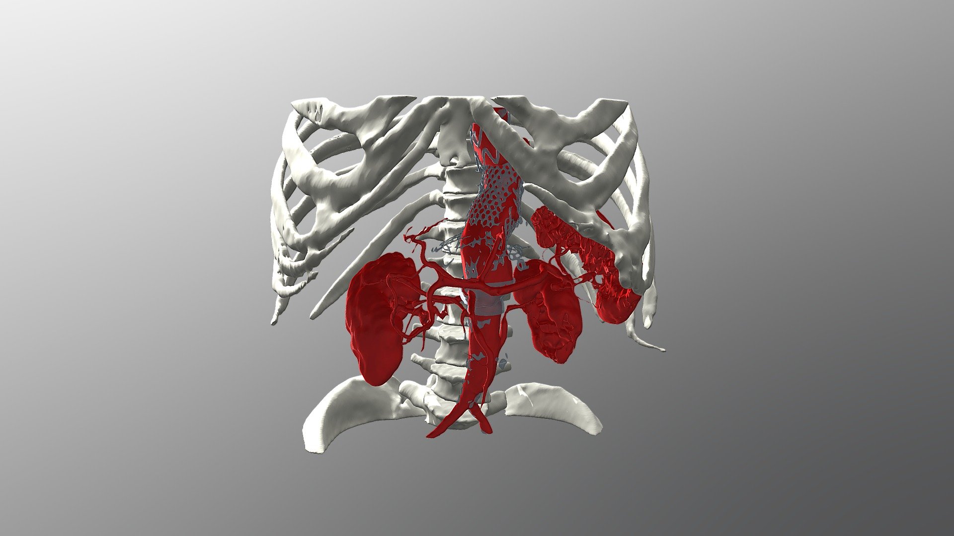 Thoracoabdominal aneurysm - 3D model by valchanov [74d6672] - Sketchfab