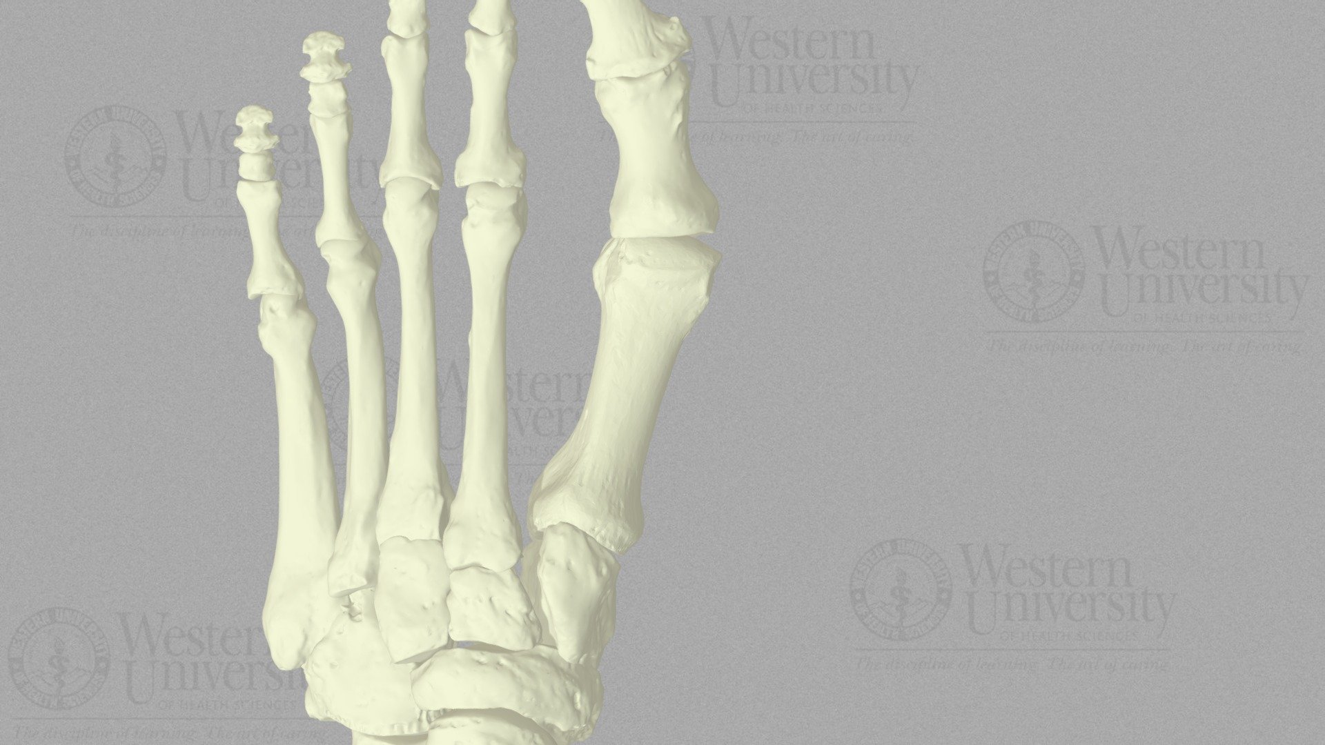 Opening Base Wedge Osteotomy - First Metatarsal - 3D model by ...